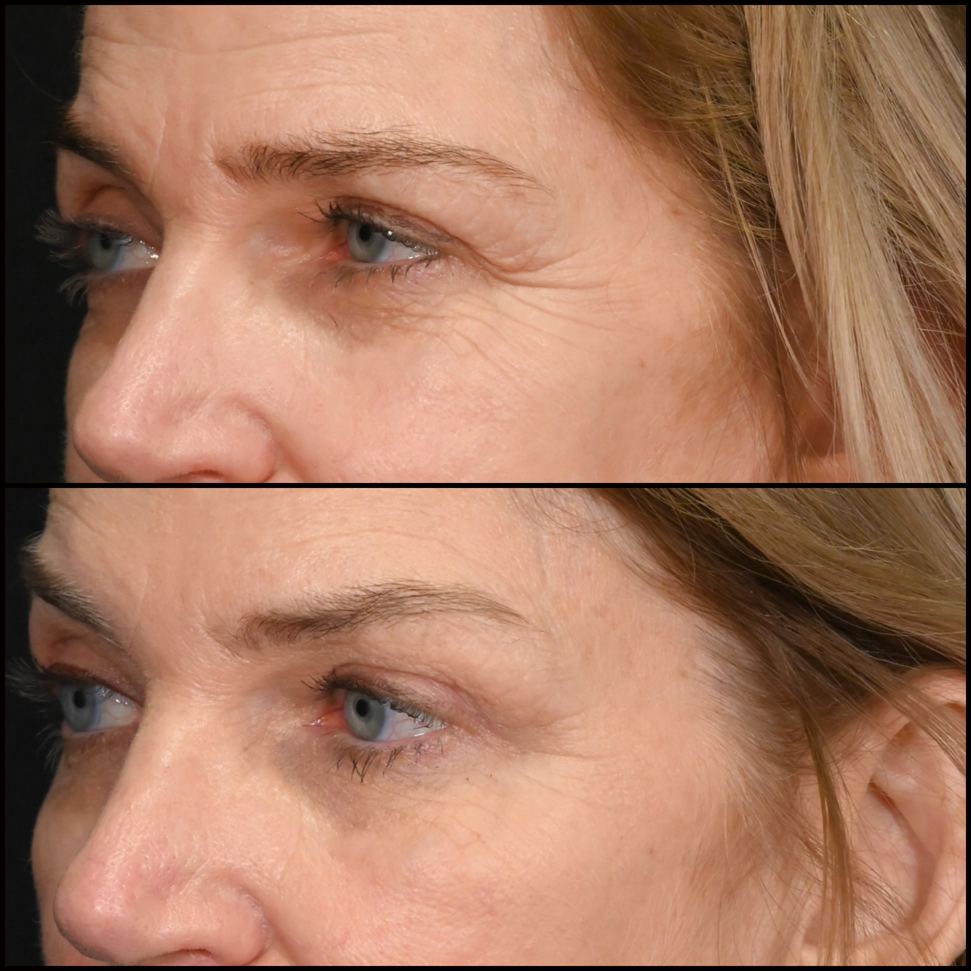Brow Lift Before & After Photos | Flora Levin MD