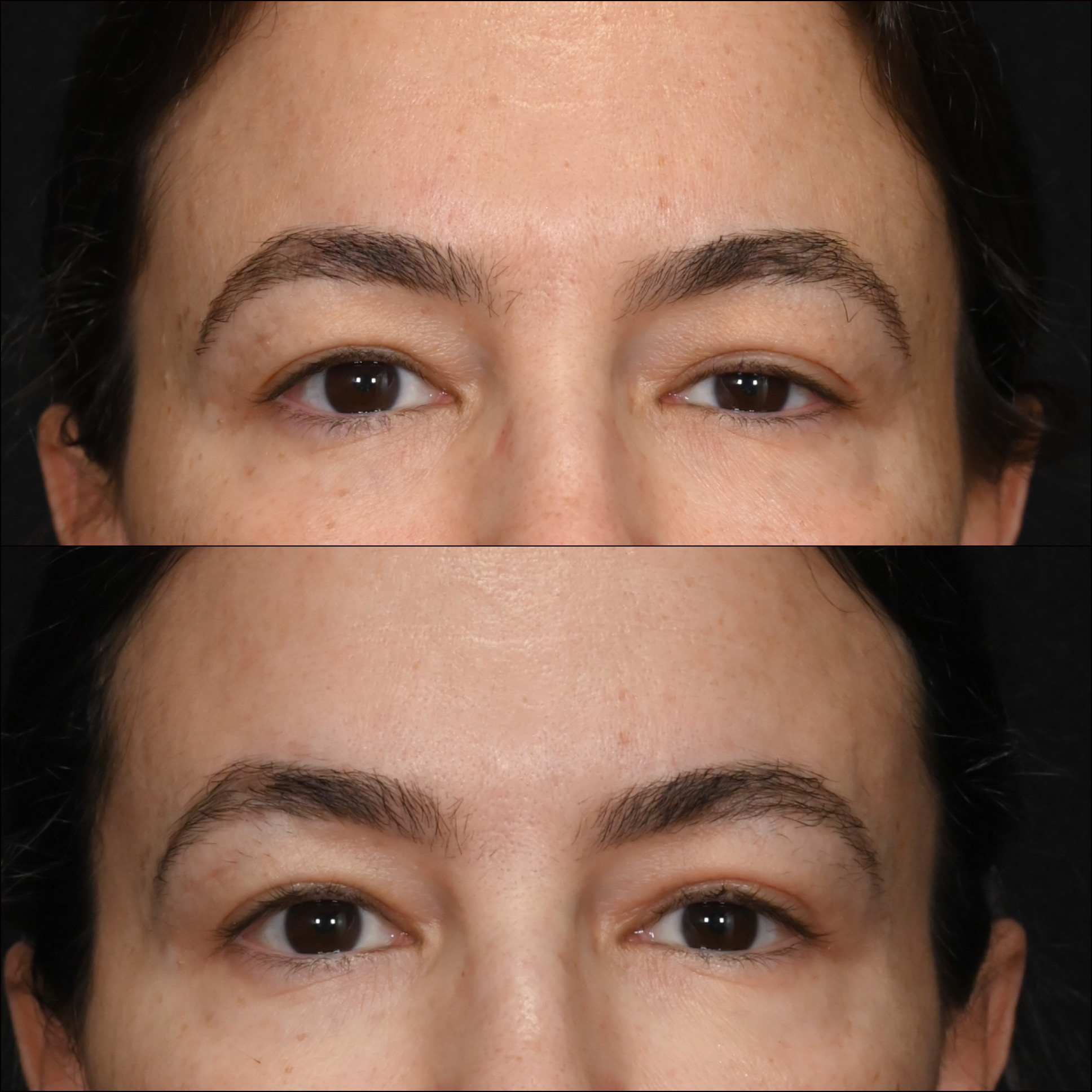 Revision Surgery Before & After Photos | Flora Levin MD