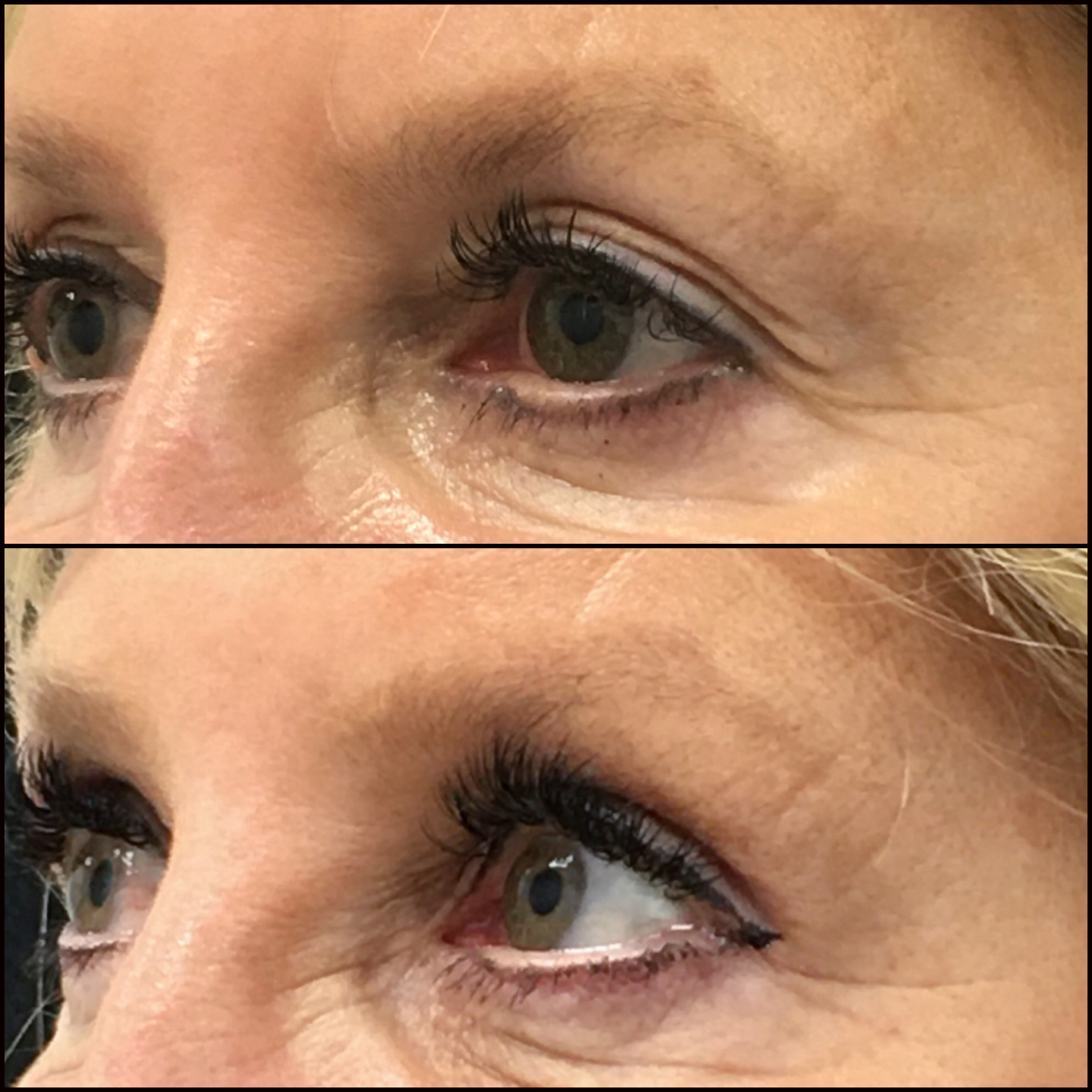 Brow Lift Before & After Photos | Flora Levin MD