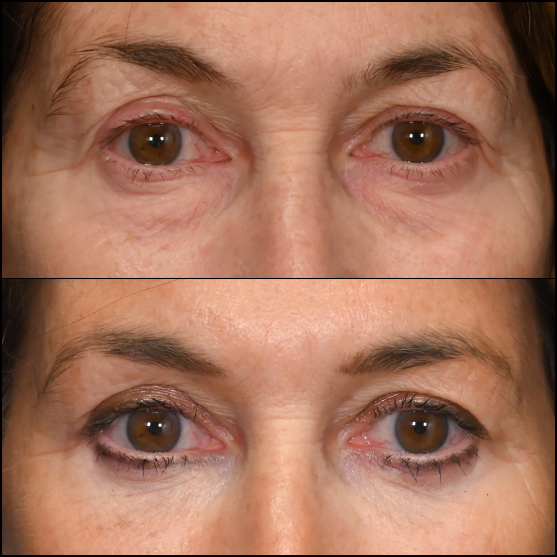 Lower Blepharoplasty Before & After Photos | Flora Levin MD
