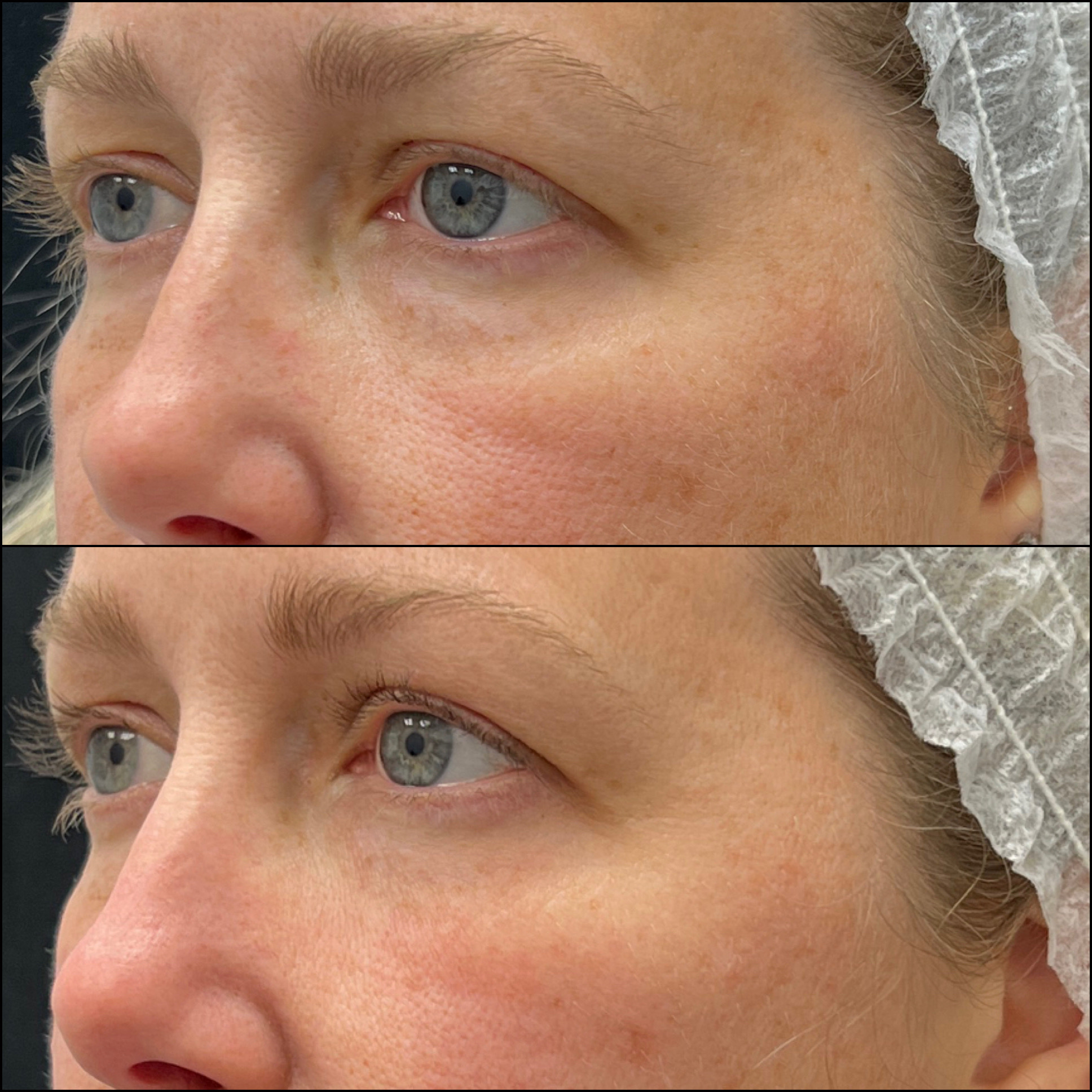 Microneedling Before & After Photos | Flora Levin MD