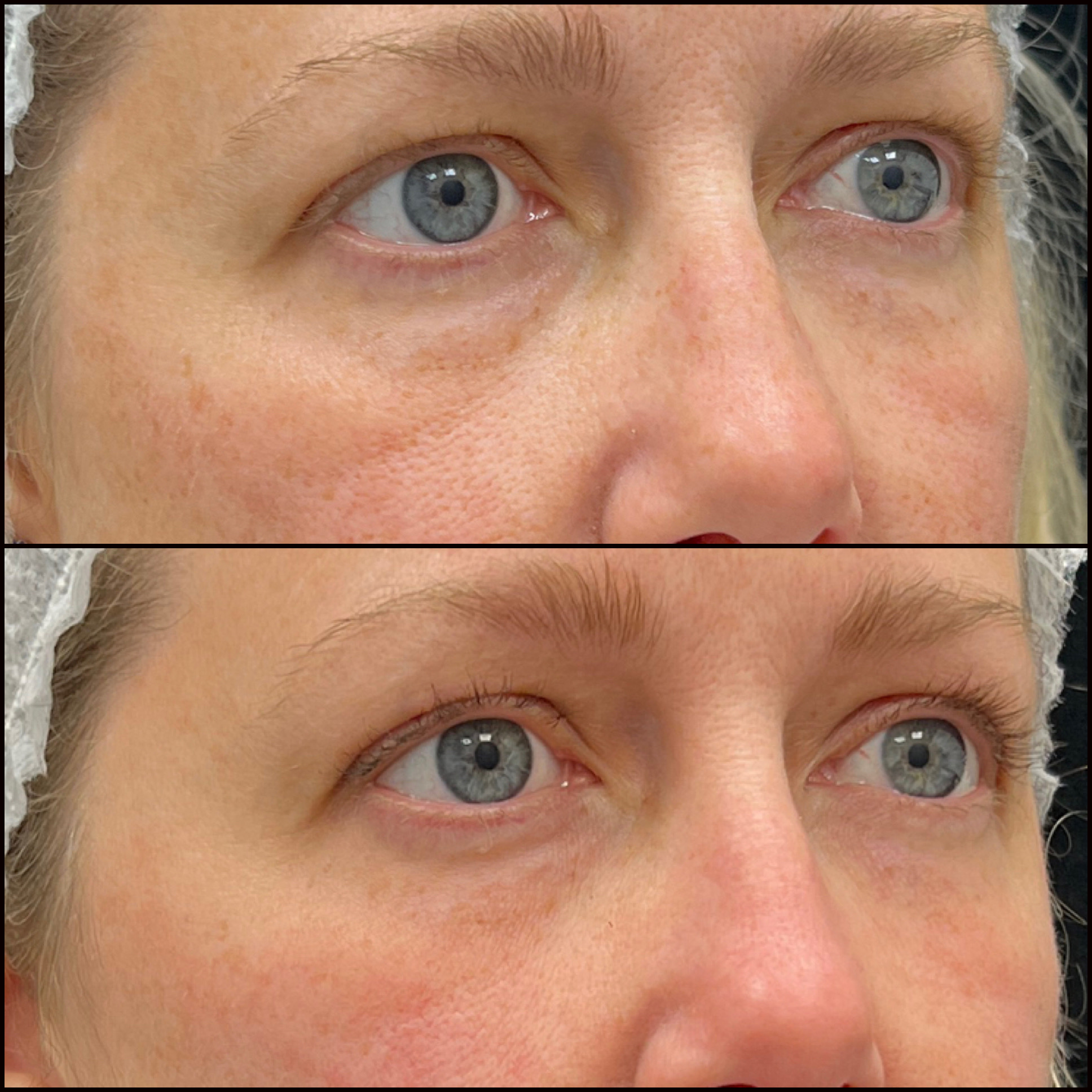 Microneedling Before & After Photos | Flora Levin MD