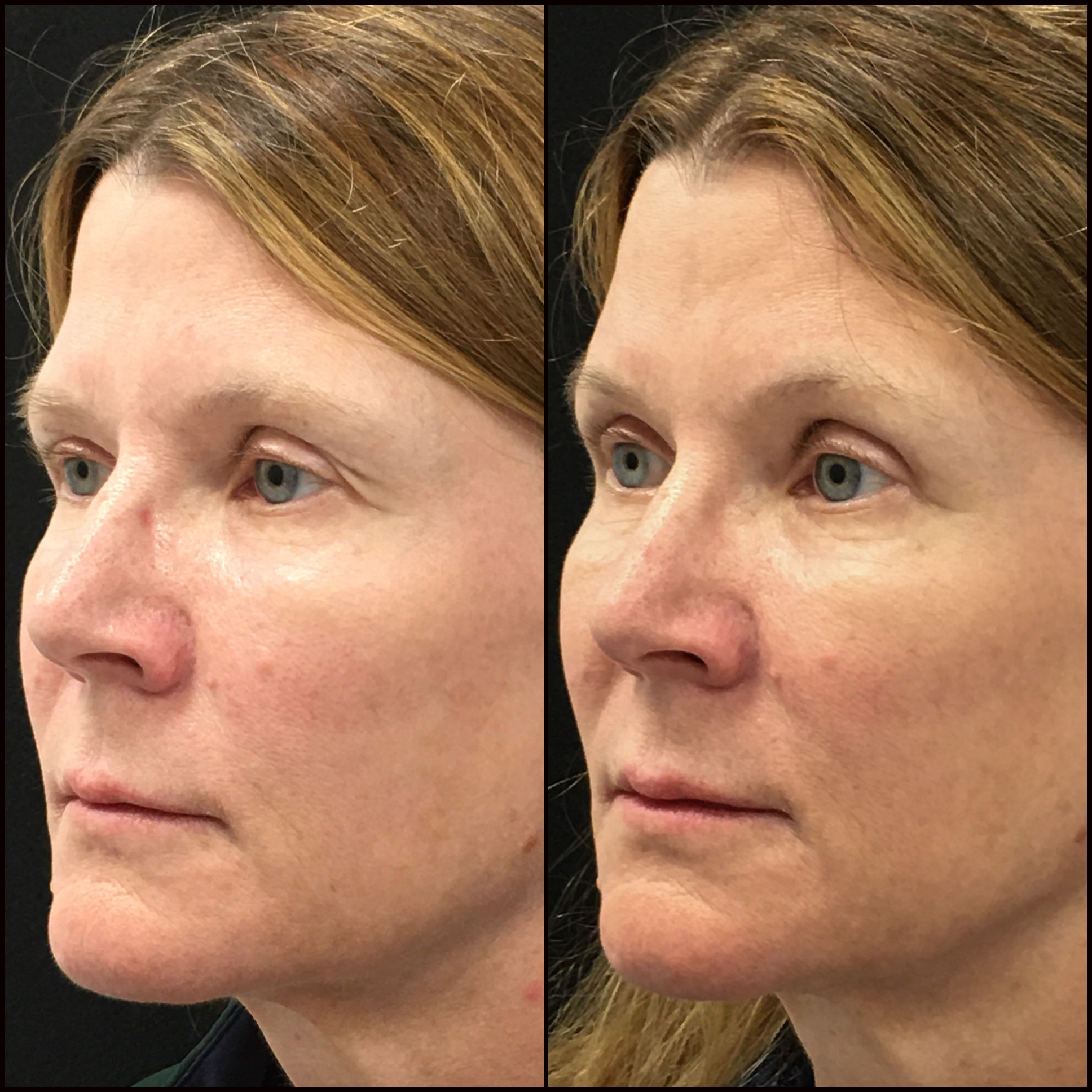 Upper Blepharoplasty Before & After Photos | Flora Levin MD