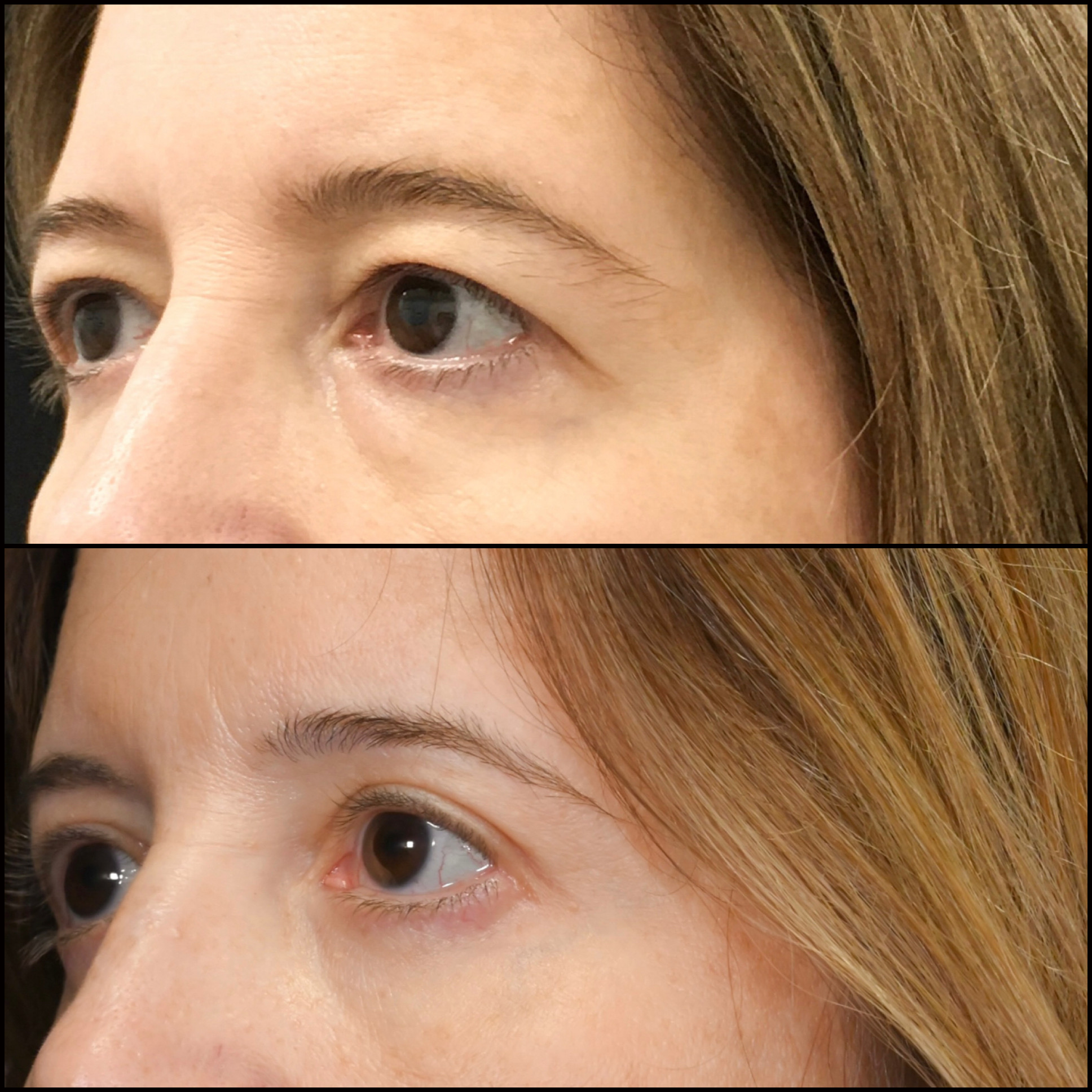 Lower Blepharoplasty Before & After Photos | Flora Levin MD