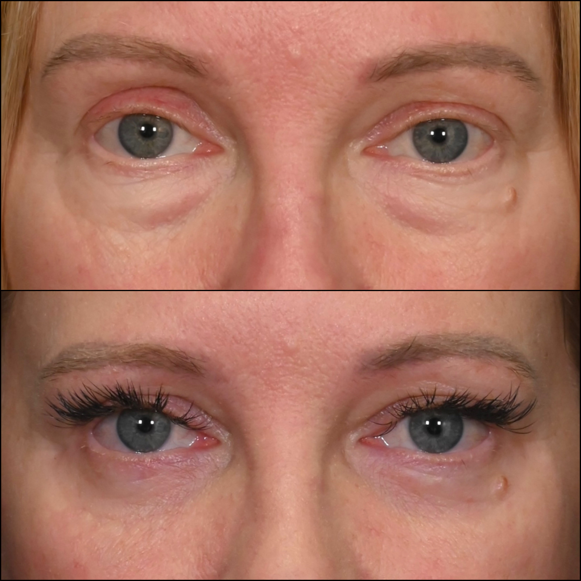 Lower Blepharoplasty Before & After Photos | Flora Levin MD