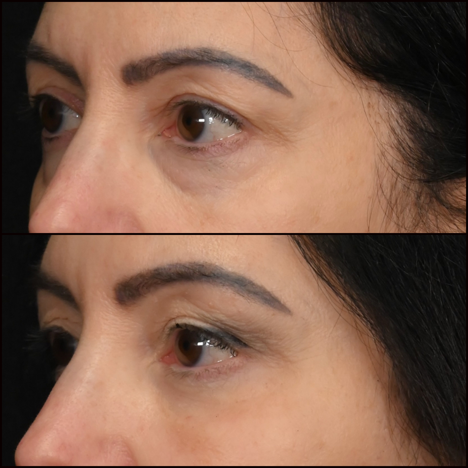 Lower Blepharoplasty Before And After Photos Flora Levin Md