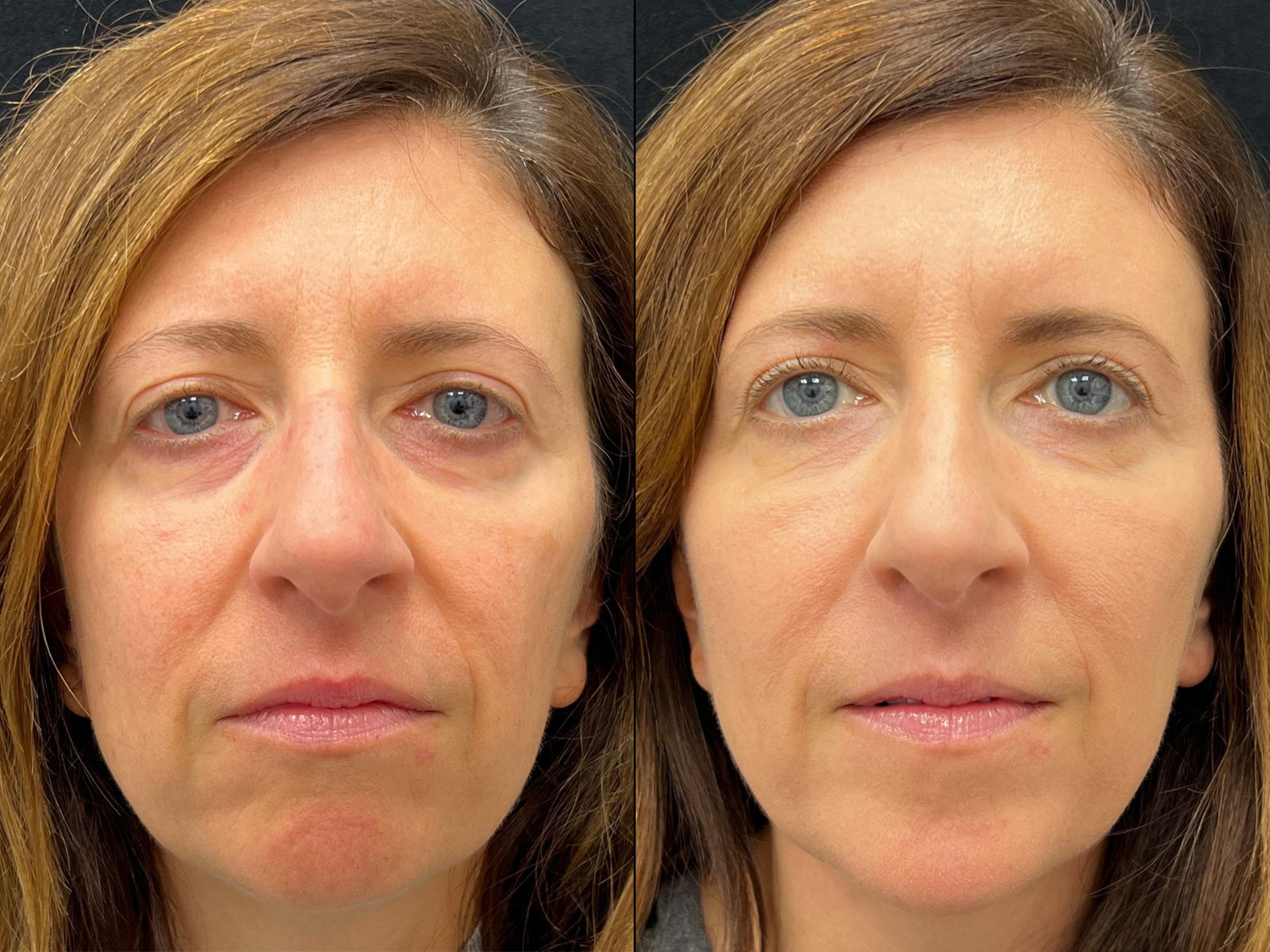 Dermal Fillers Before & After Photos | Flora Levin MD