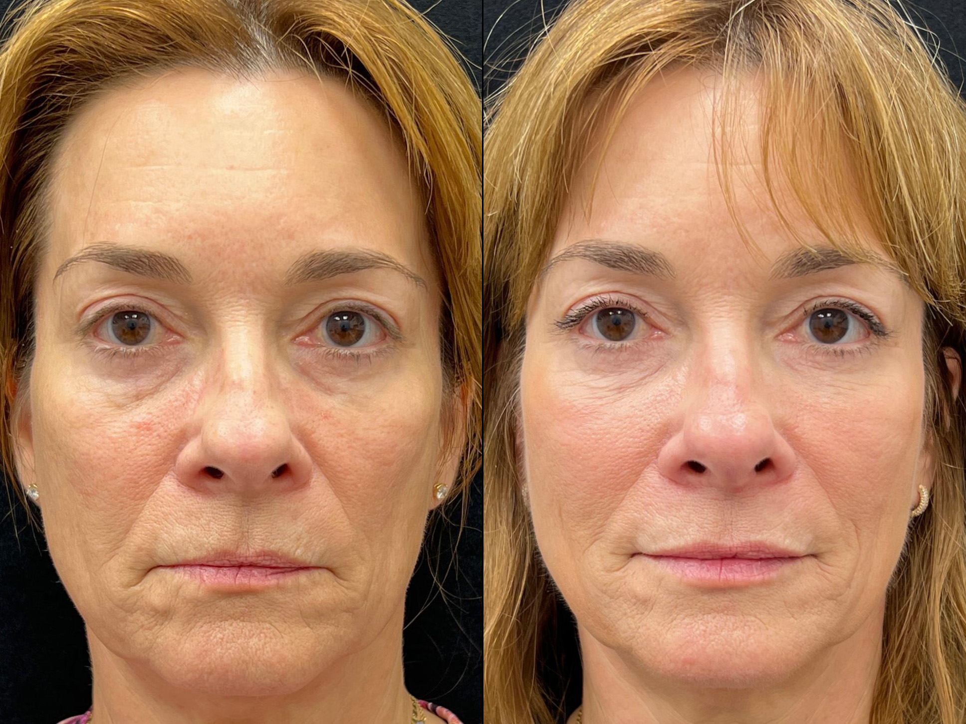 Dermal Fillers Before & After Photos | Flora Levin MD