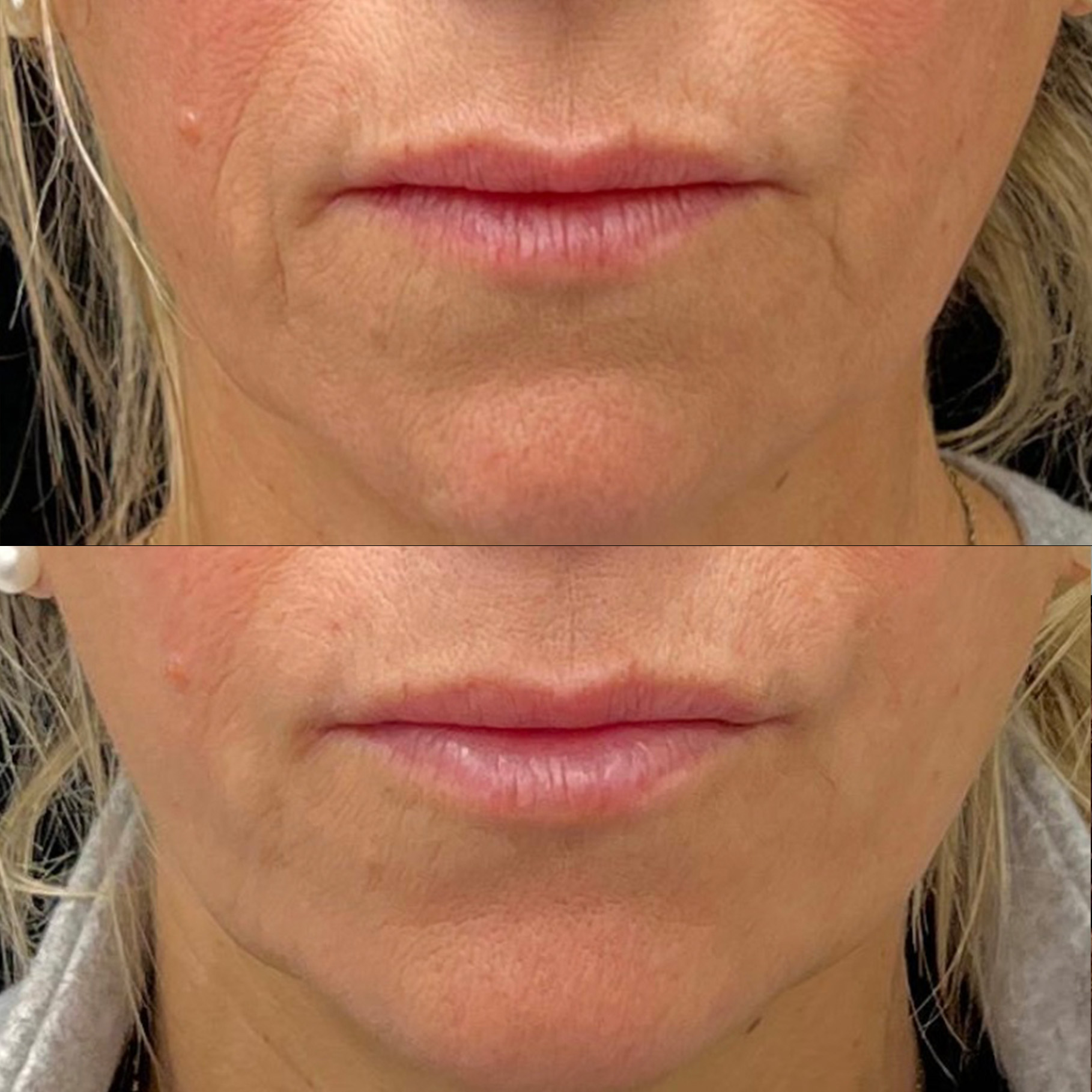 Dermal Fillers Before & After Photos | Flora Levin MD