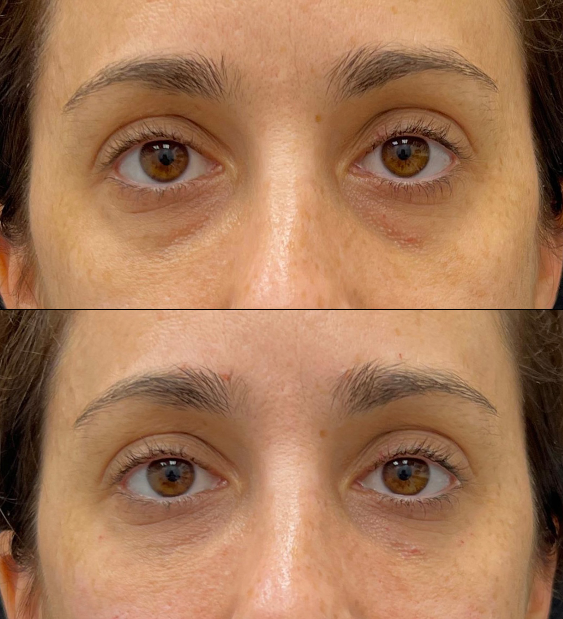 Patient 204604 | Eyelid Filler Before & After Photos | Flora Levin MD