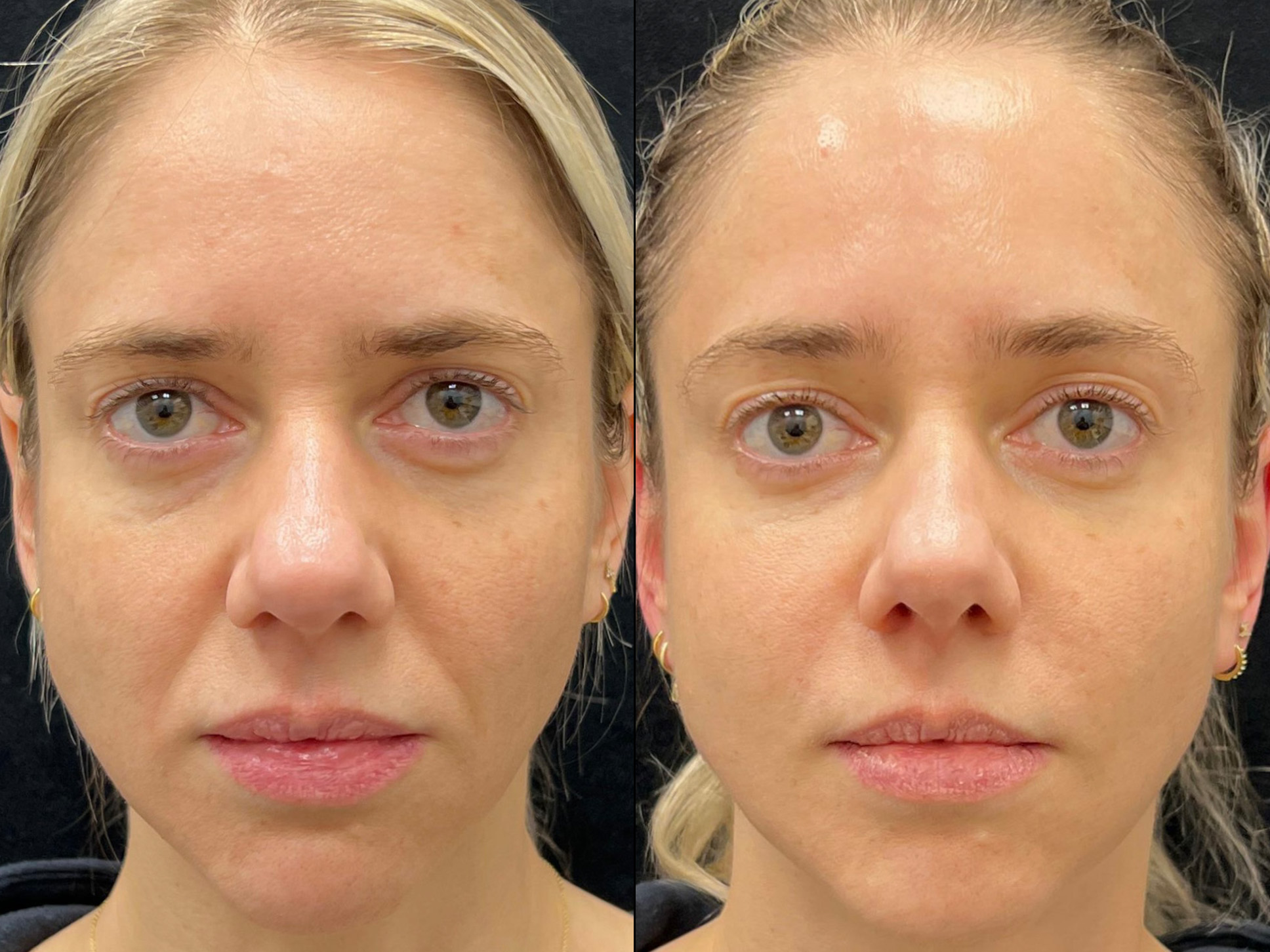 Dermal Fillers Before & After Photos | Flora Levin MD