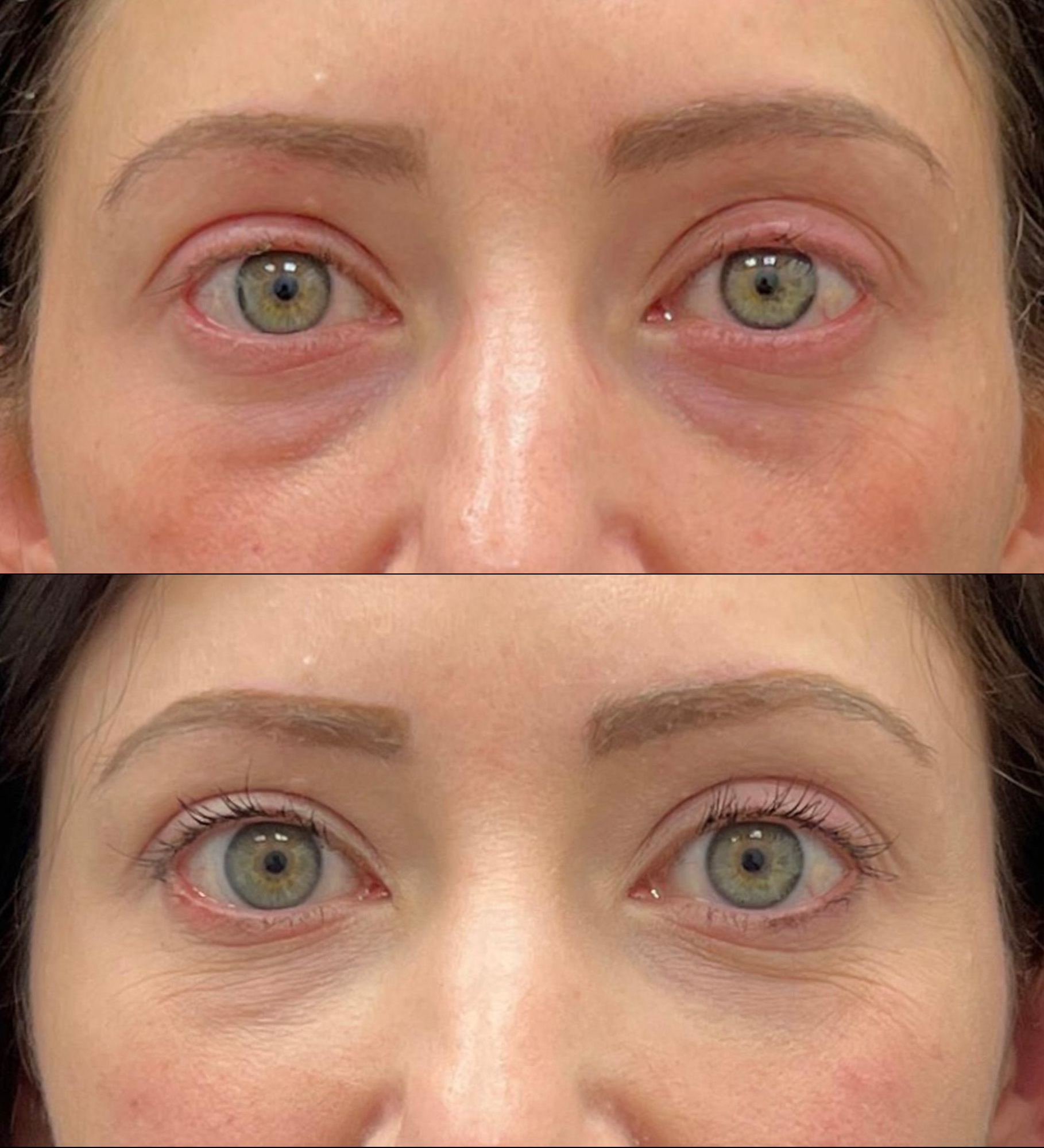 Eyelid Filler Before & After Photos | Flora Levin MD