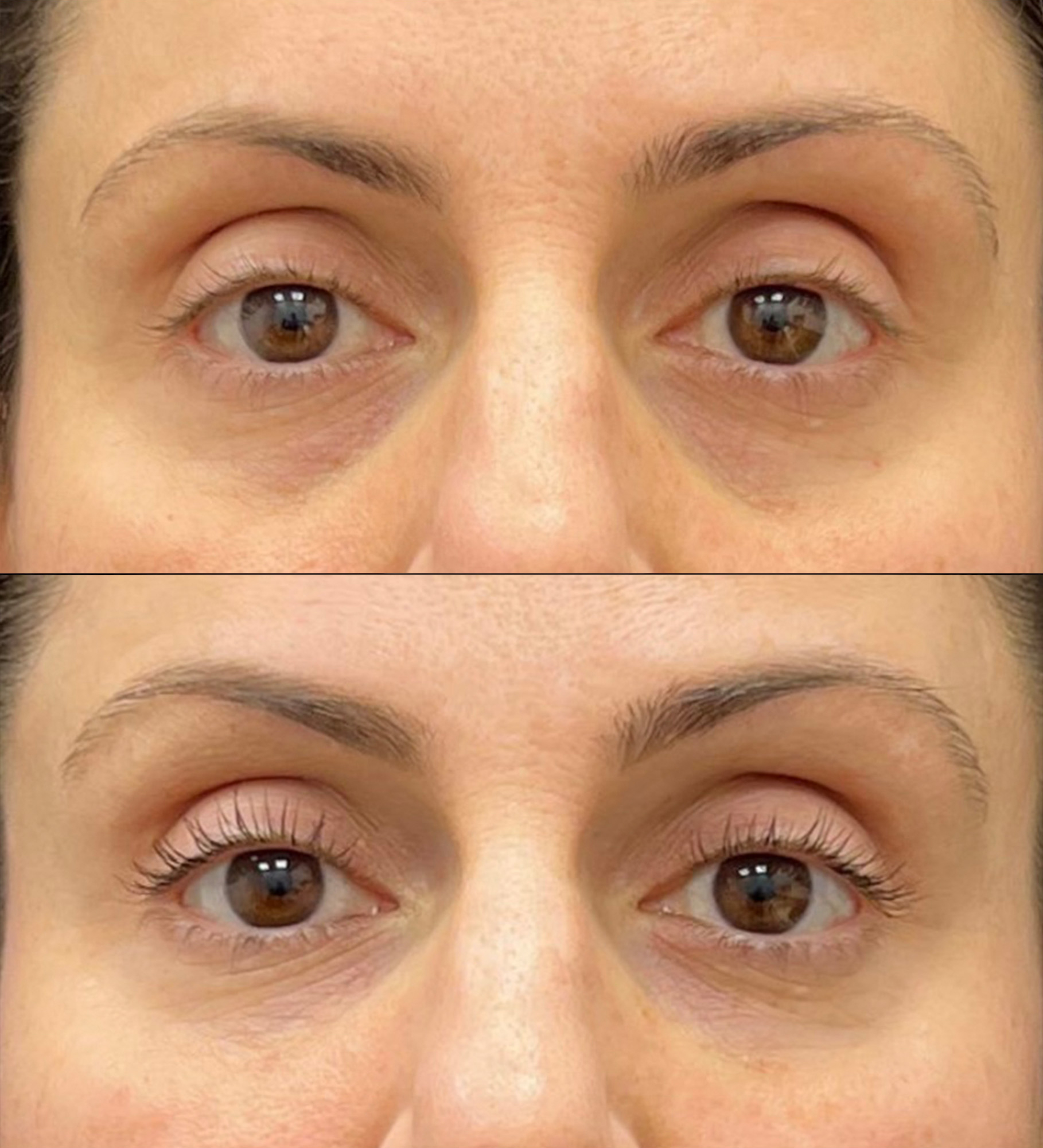 Eyelid Filler Before & After Photos | Flora Levin MD