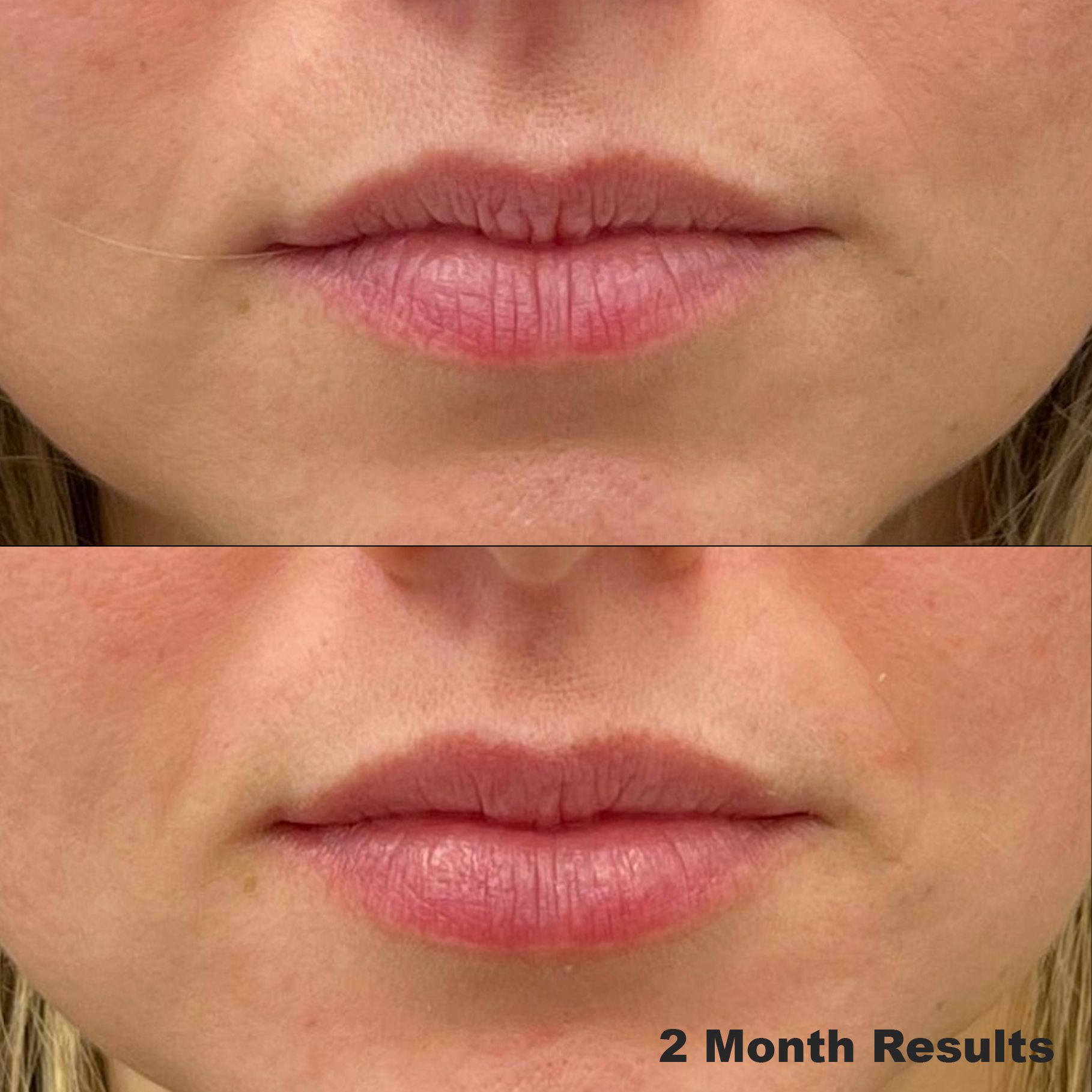 Lip Enhancement Before & After Photos | Flora Levin MD