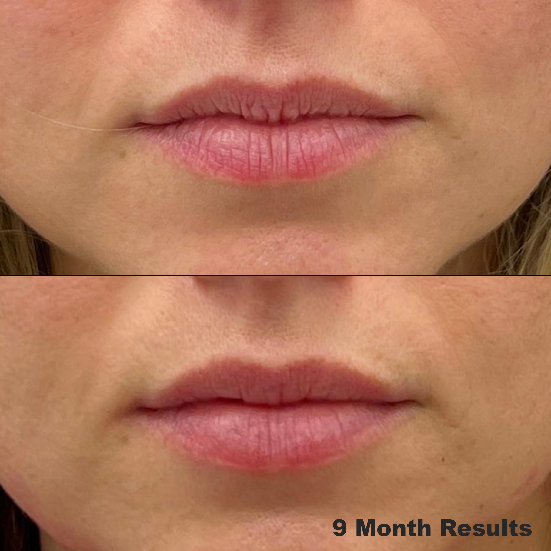 Lip Enhancement Before & After Photos | Flora Levin MD