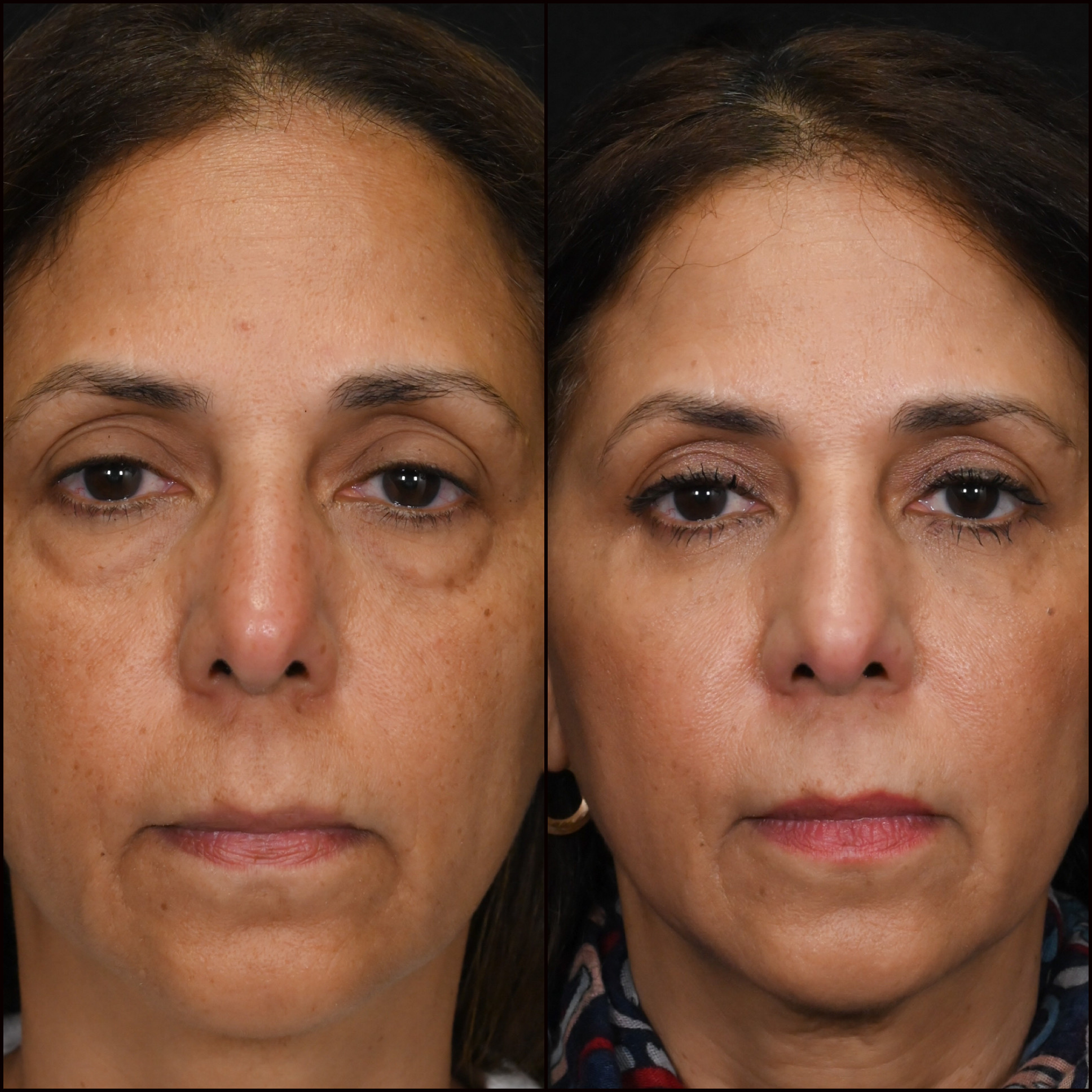 Patient 410892 Lower Blepharoplasty Before And After Photos Flora Levin Md
