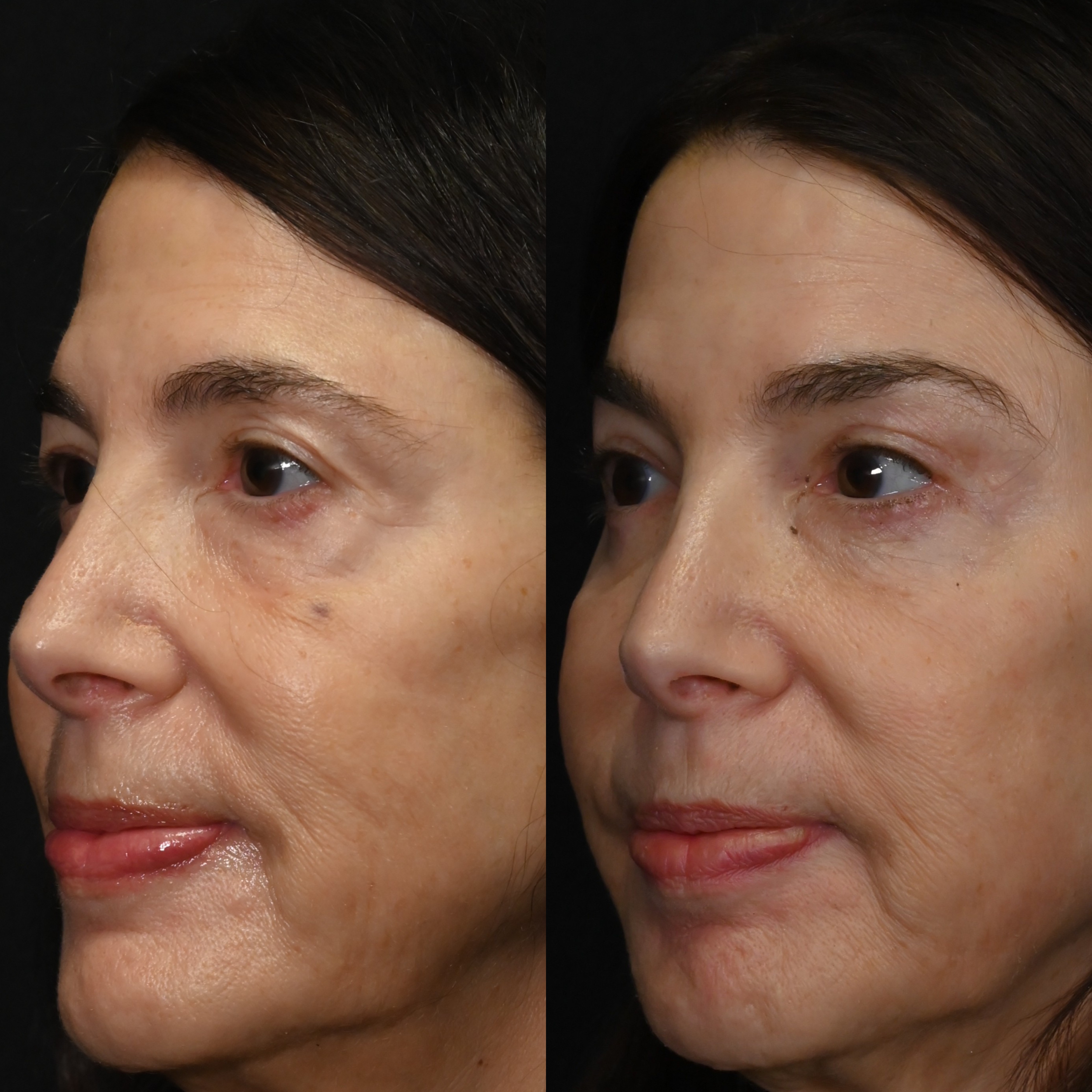 Brow Lift Before & After Photos | Flora Levin MD