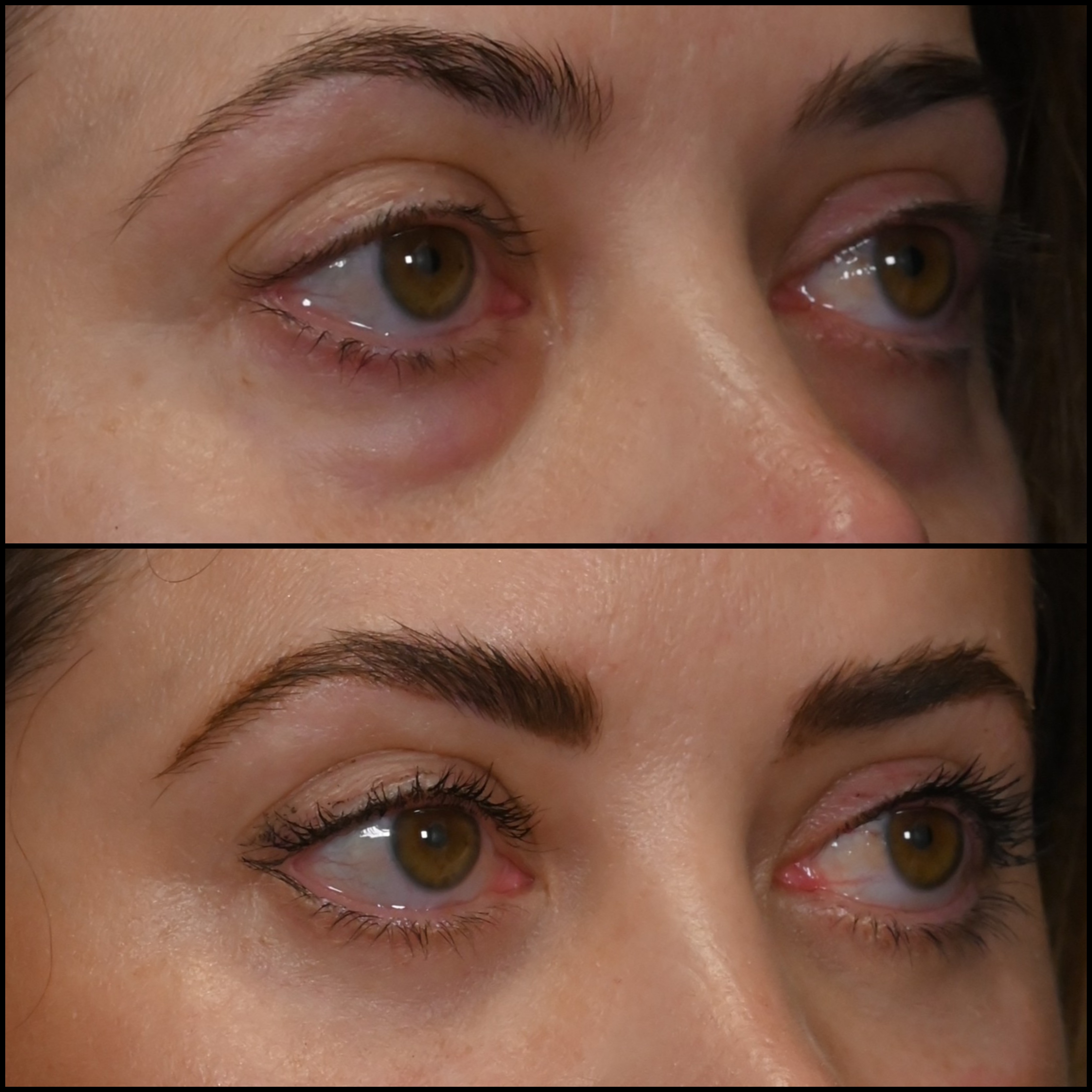 Lower Blepharoplasty Before & After Photos | Flora Levin MD
