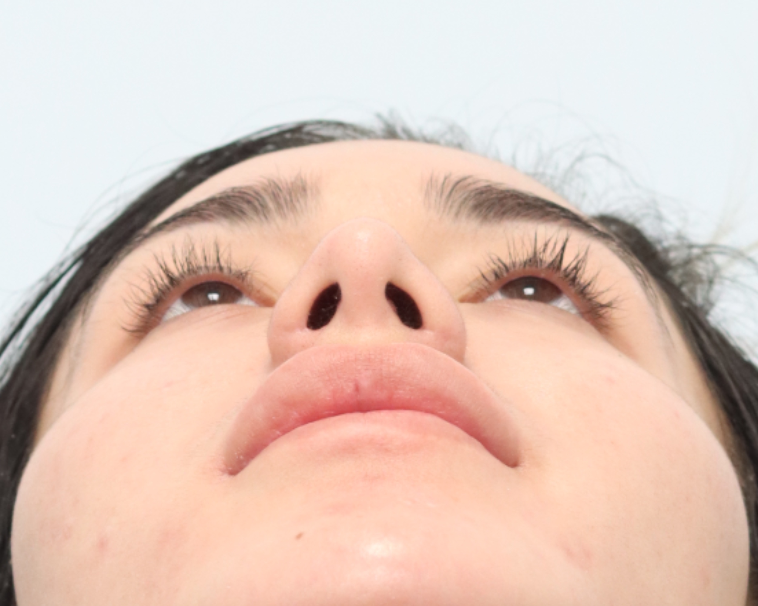 Patient 327386 | Rhinoplasty Before & After Photos | That Face Chicago