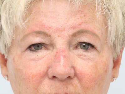 Reconstructive Before & After Photos | That Face Chicago