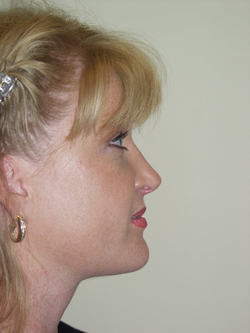 Patient 53599948 Submental Liposuction Before And After Photos Texas