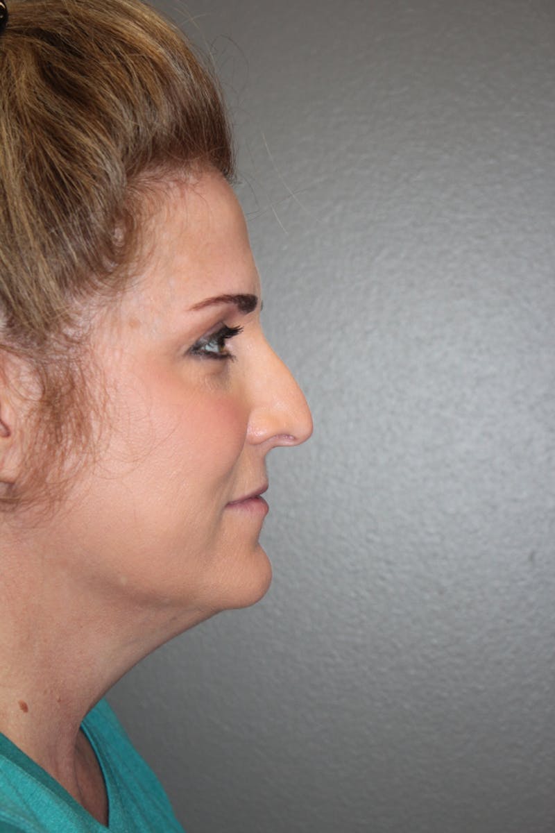 Patient 141113662 Submental Liposuction Before And After Photos Texas Facial Plastic Surgery