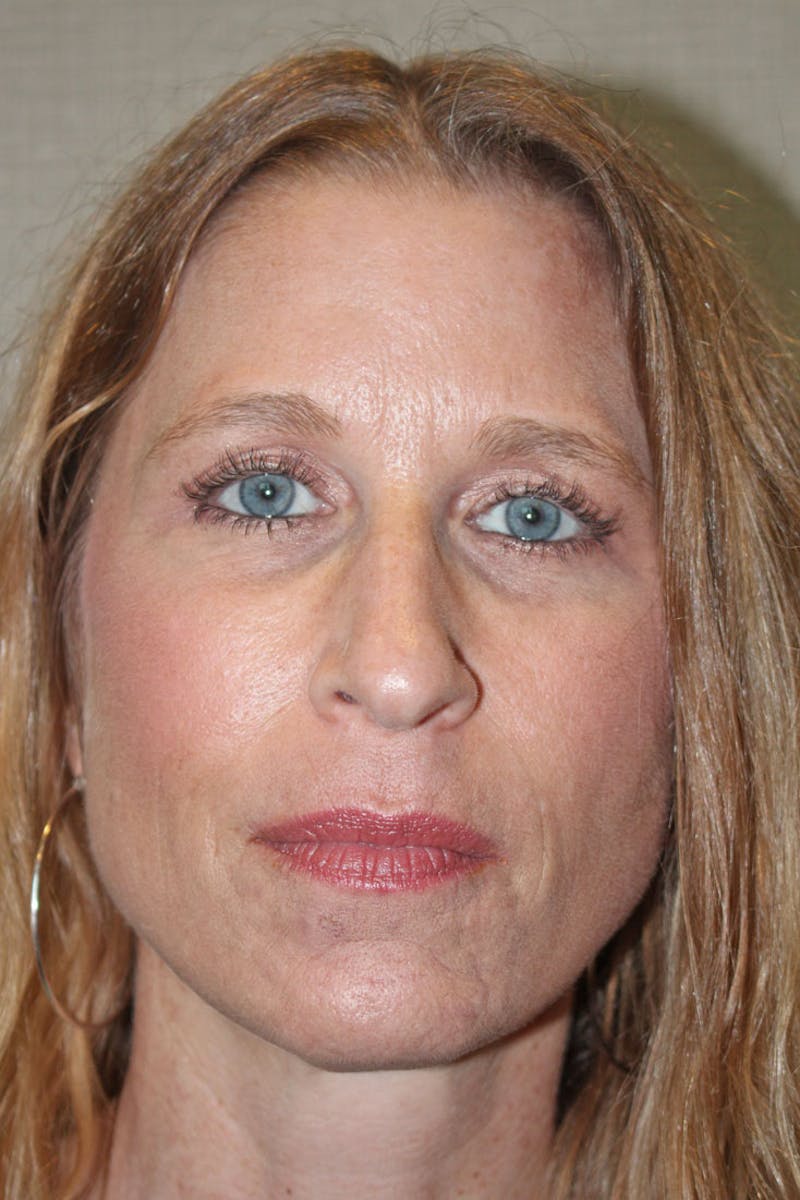 Patient 146669152 Chemical Peel Before And After Photos Texas Facial Plastic Surgery