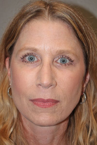 Chemical Peel Before And After Photos Texas Facial Plastic Surgery
