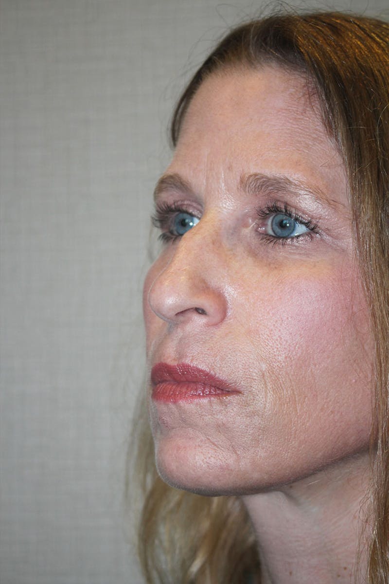 Patient 146669152 Chemical Peel Before And After Photos Texas Facial