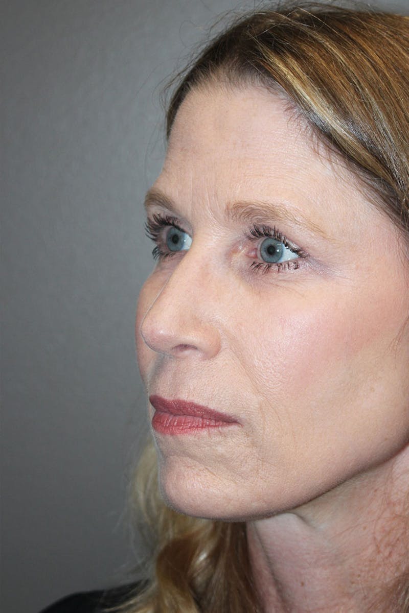 Patient 146669147 Eyelid Surgery Before And After Photos Texas Facial Plastic Surgery