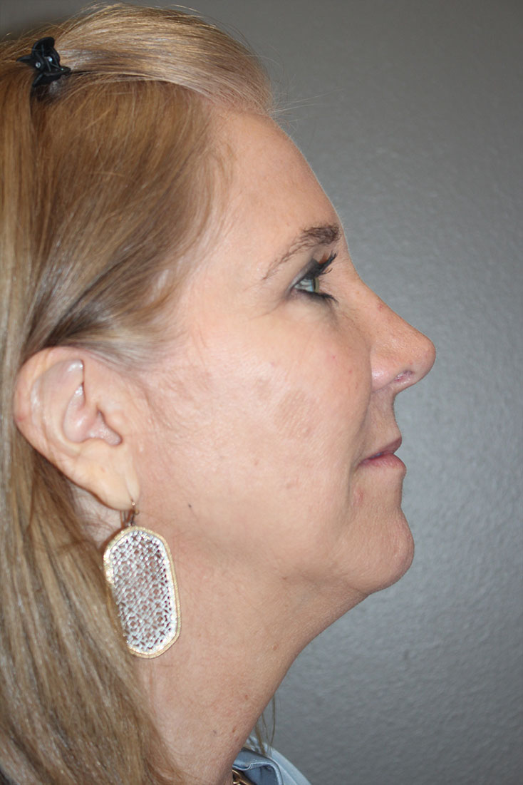 Patient 146669153 Chemical Peel Before And After Photos Texas Facial