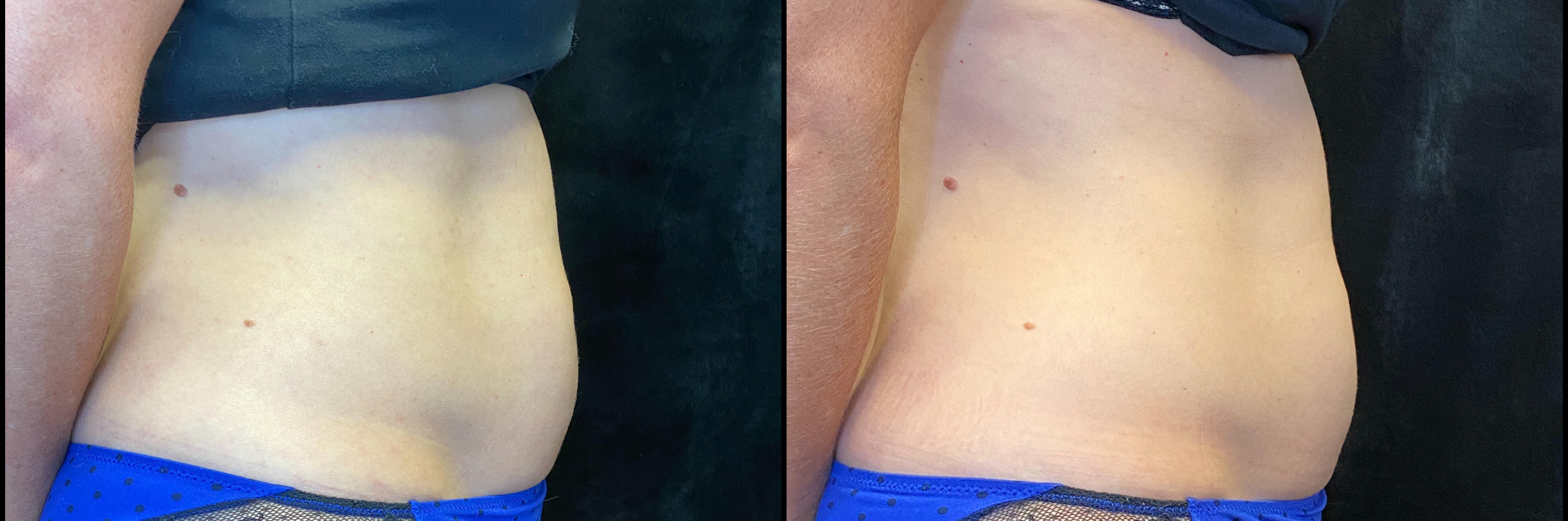 Patient 154143634 | EvolveX Before & After Photos | Modern Women's ...