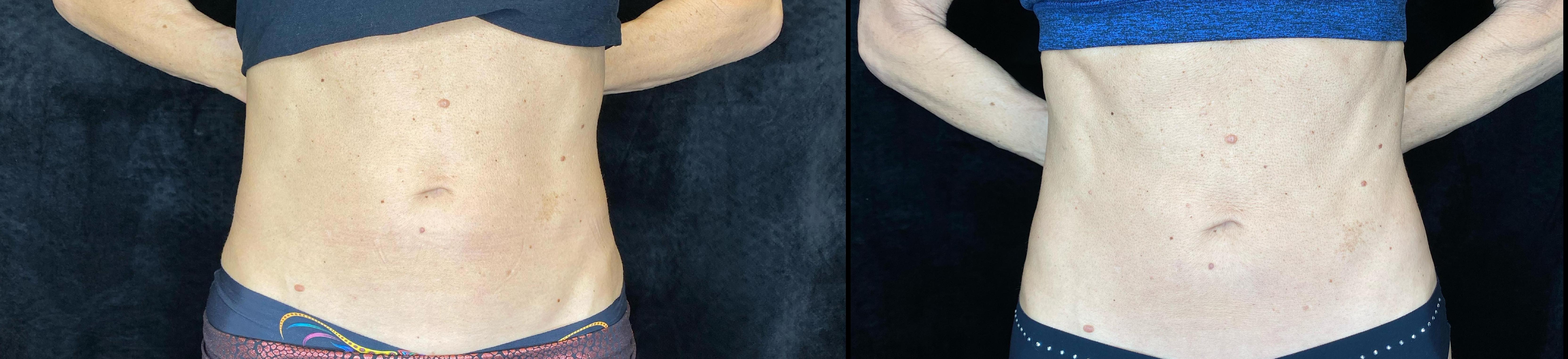 Patient 121120369 | EvolveX Before & After Photos | Modern Women's ...