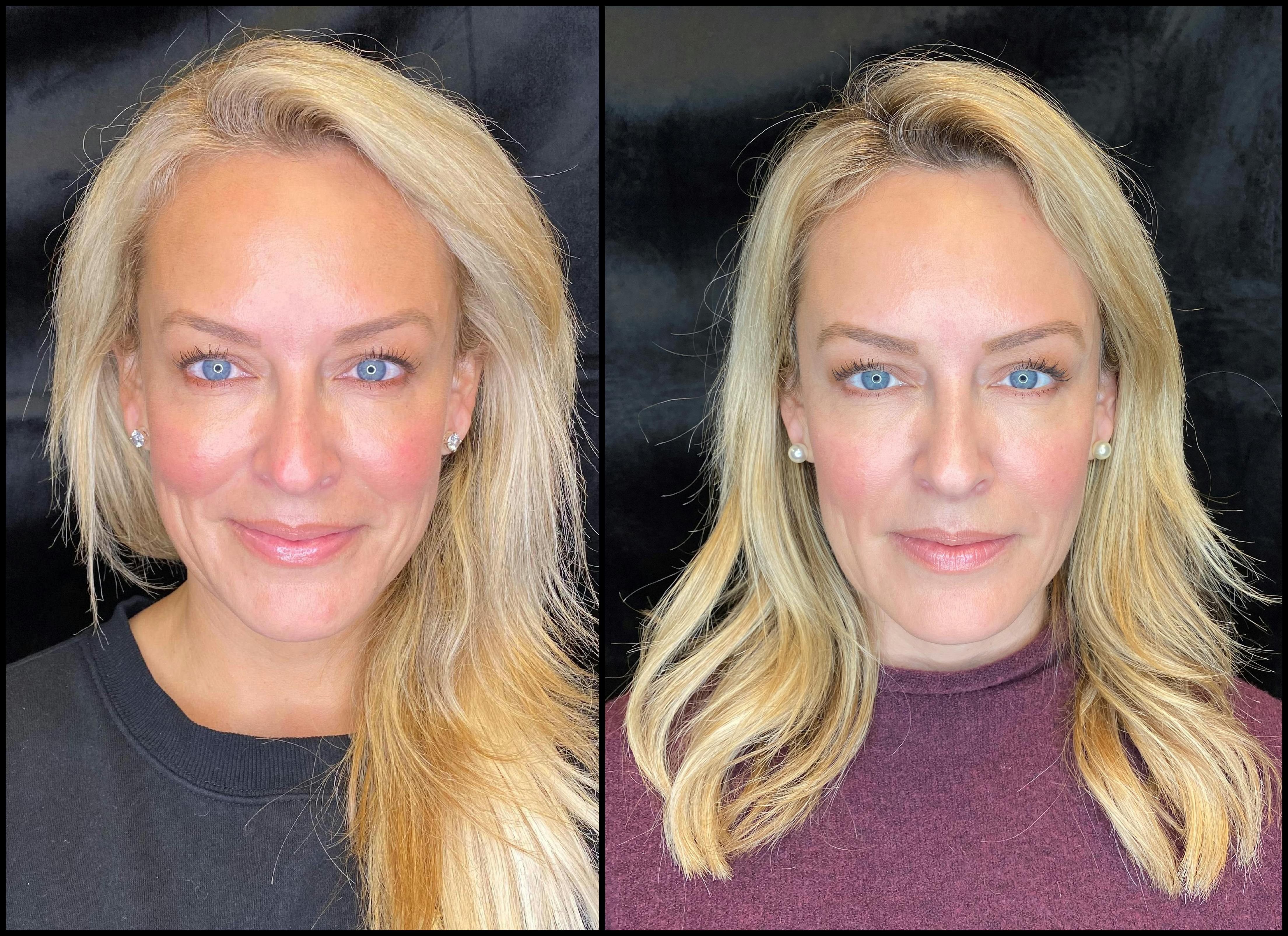 Patient 92120615 | Morpheus8 Before & After Photos | Modern Women's ...
