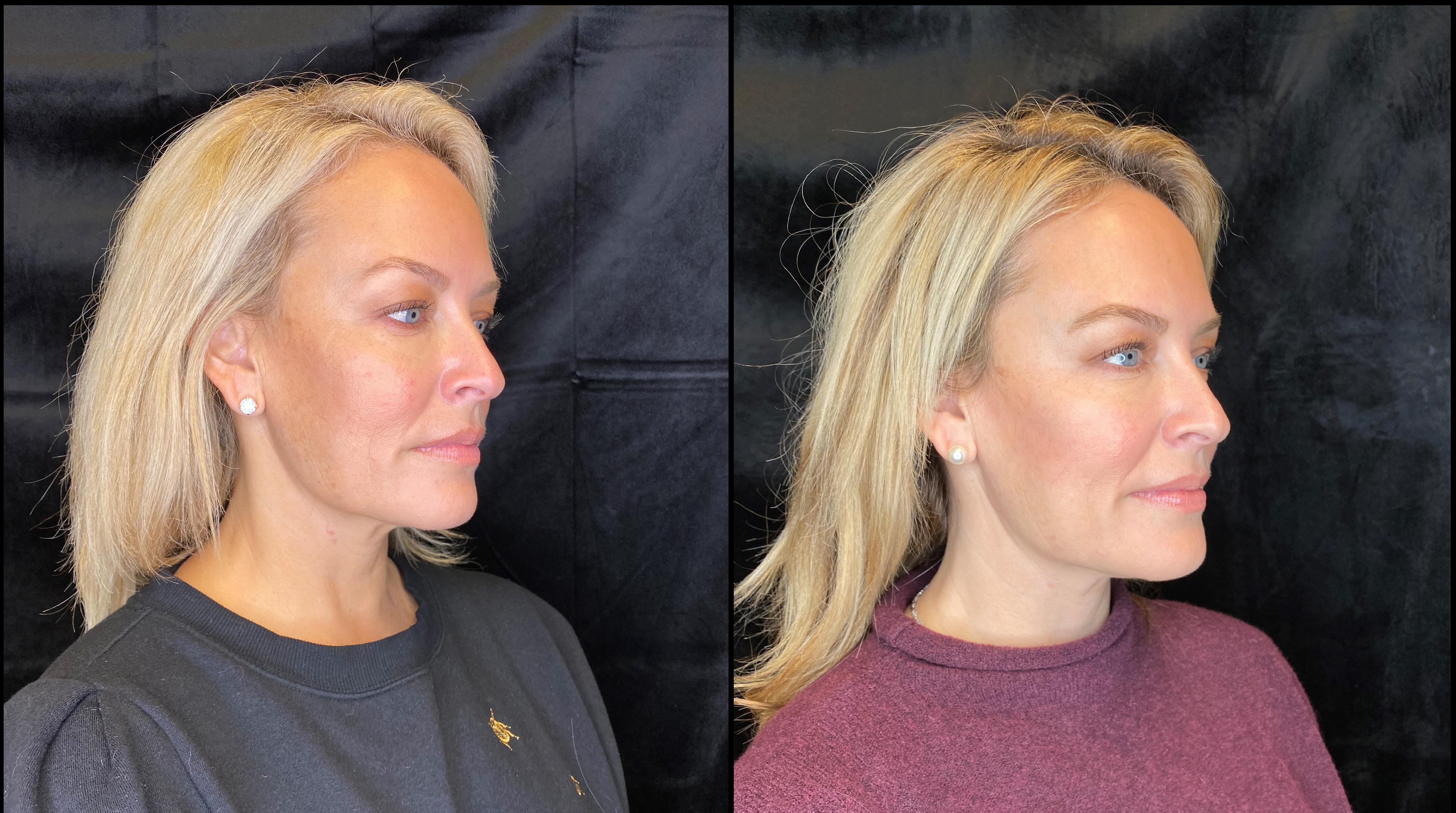 Patient 68195333 | Morpheus8 Before & After Photos | Modern Women's ...