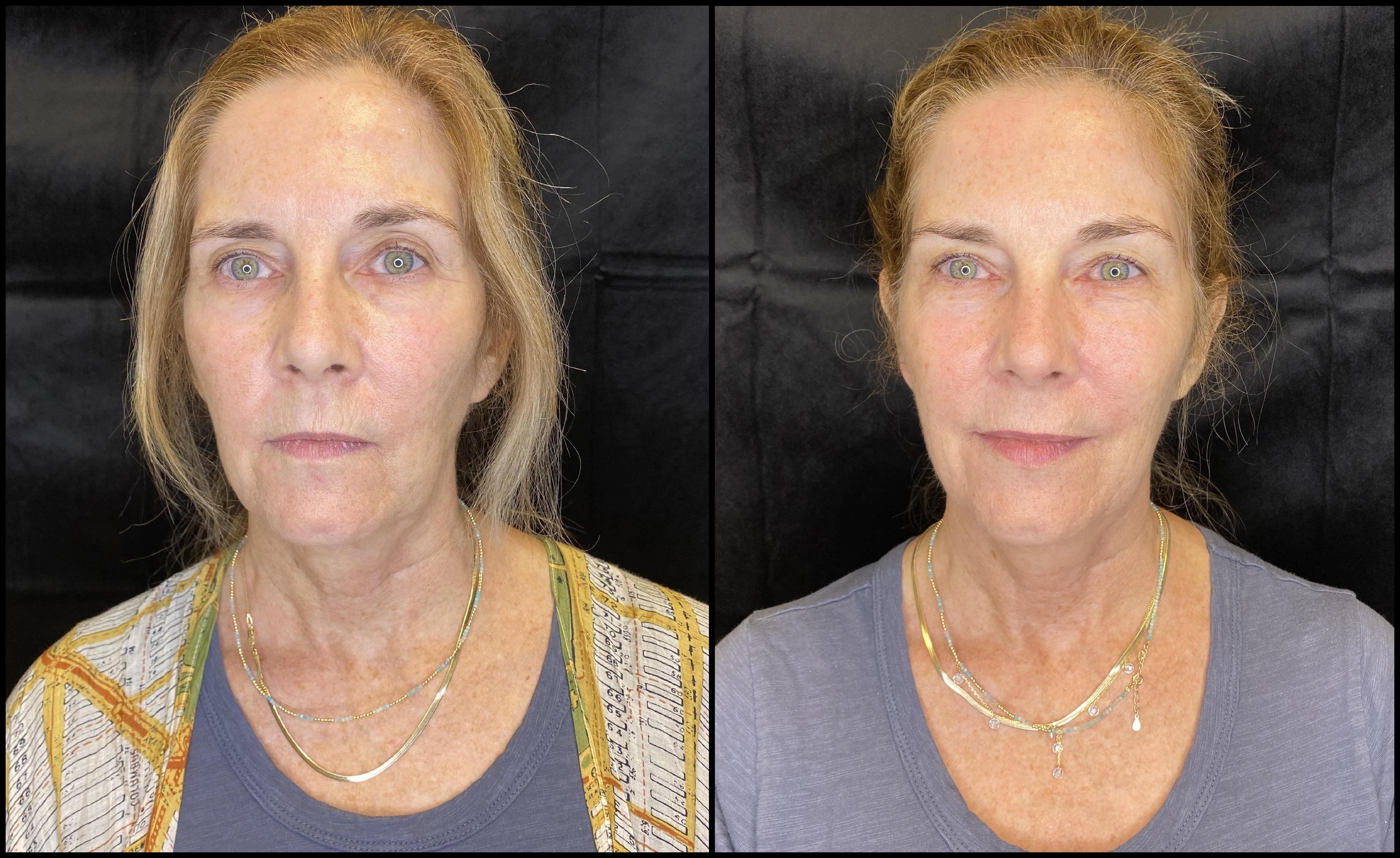 BOTOX/Dysport Before & After Photos | Modern Women's Health Gynecology ...