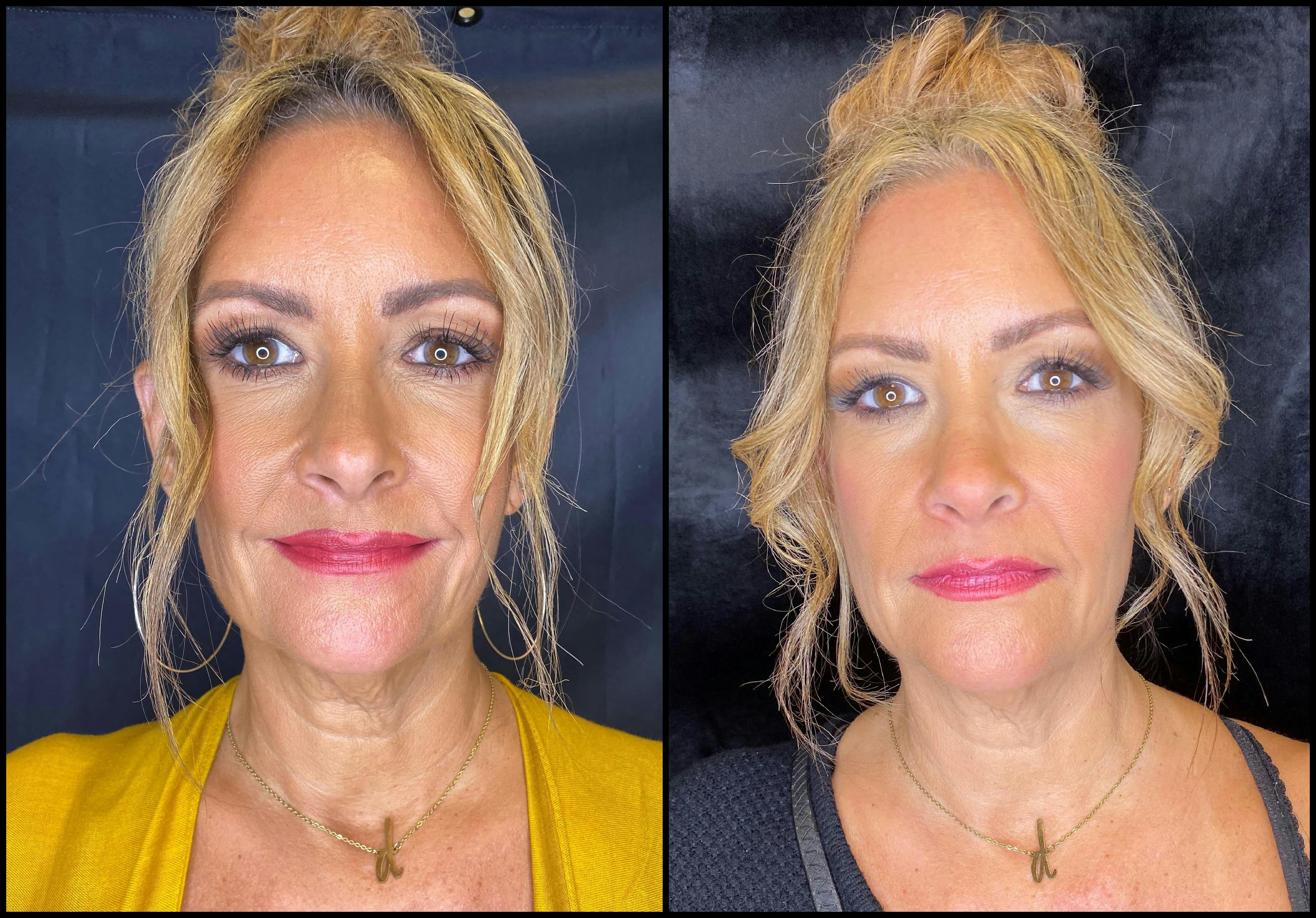 Patient 92120615 | Morpheus8 Before & After Photos | Modern Women's ...