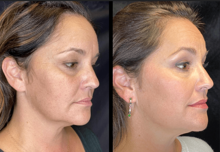 Patient 92120607 | AccuTite & FaceTite Before & After Photos | Modern ...