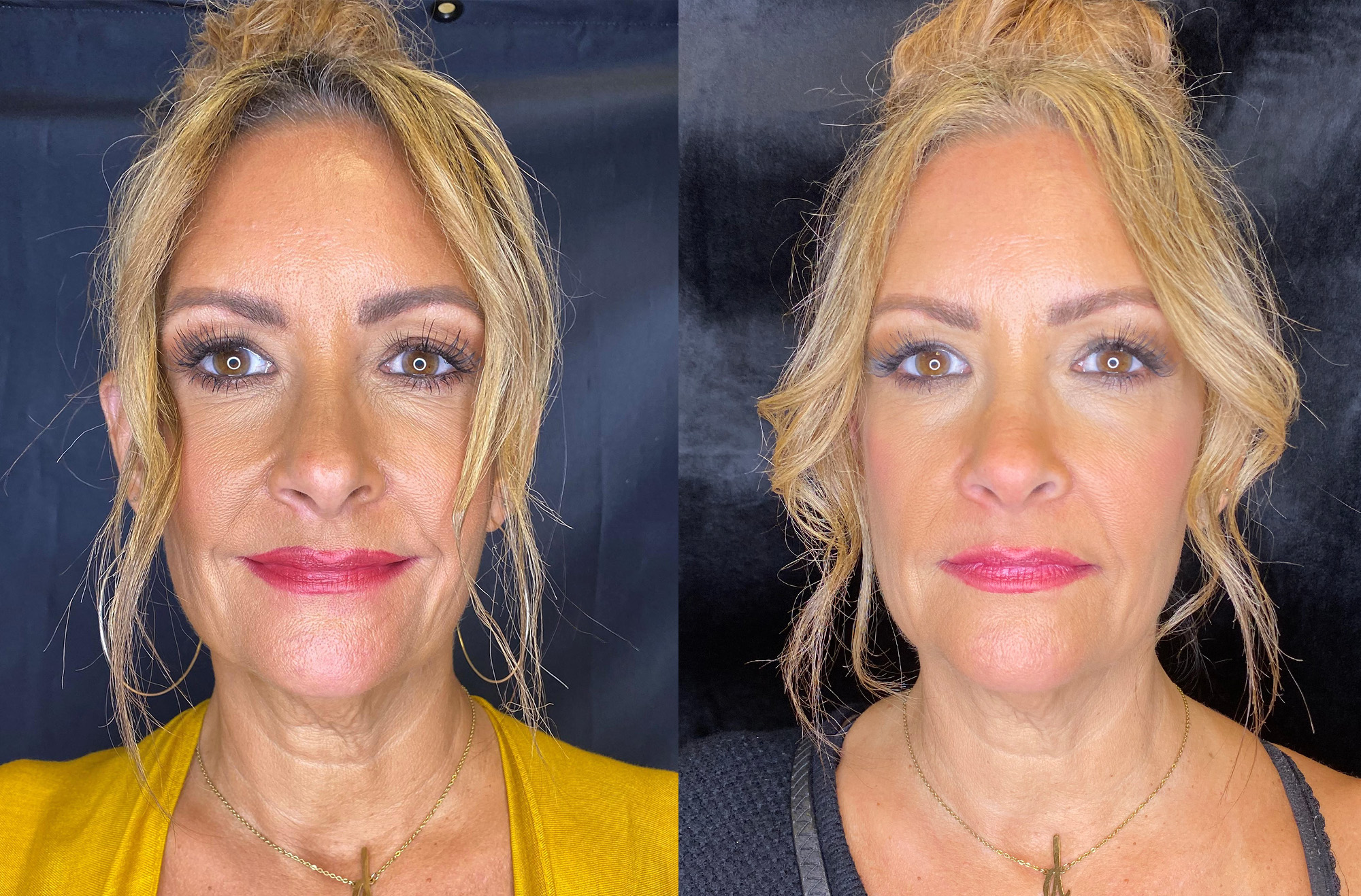 Patient 123090790 | Evoke Before & After Photos | Modern Women's Health ...