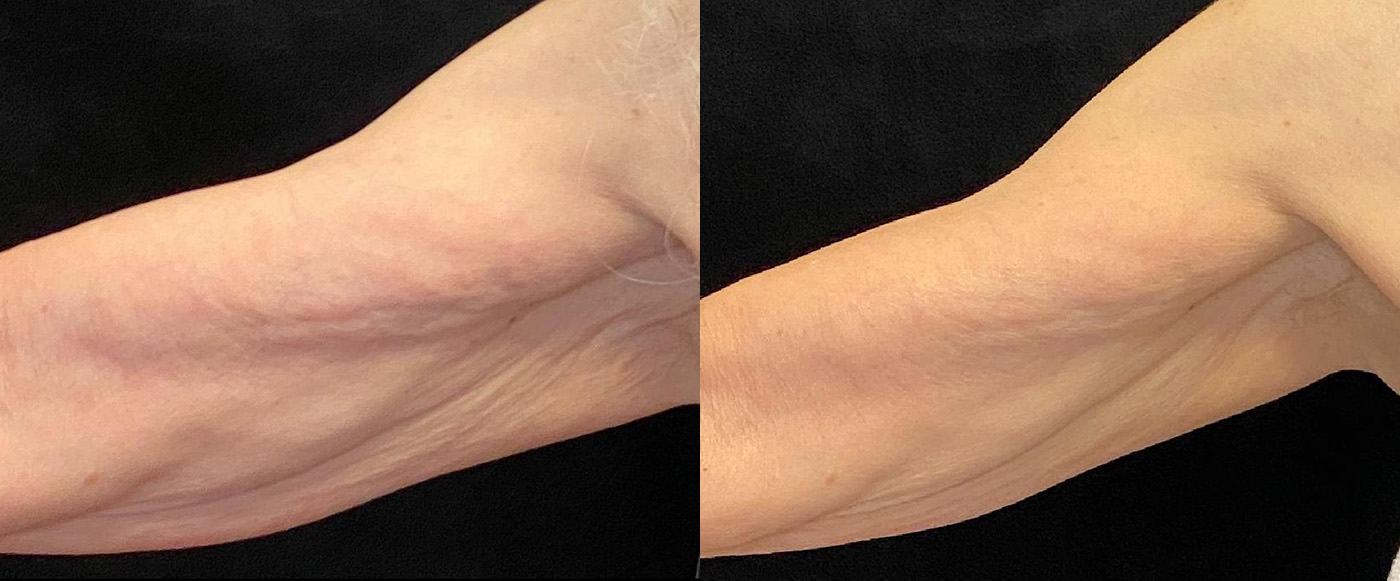 Patient 143290082 | EvolveX Before & After Photos | Modern Women's ...