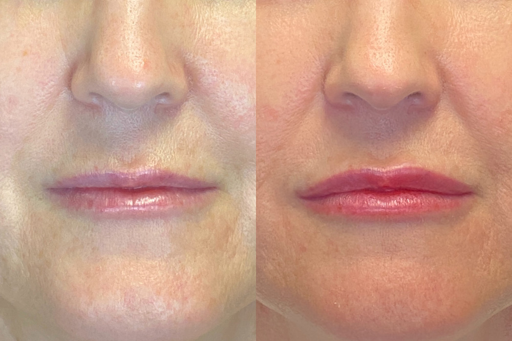 Patient 144315044 Dermal Fillers Before And After Photos Modern Women