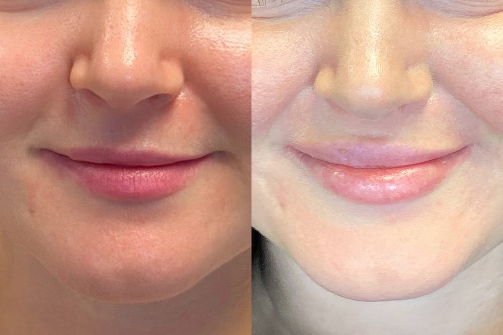 Patient 144540724 Dermal Fillers Before And After Photos Modern Womens Health Gynecology