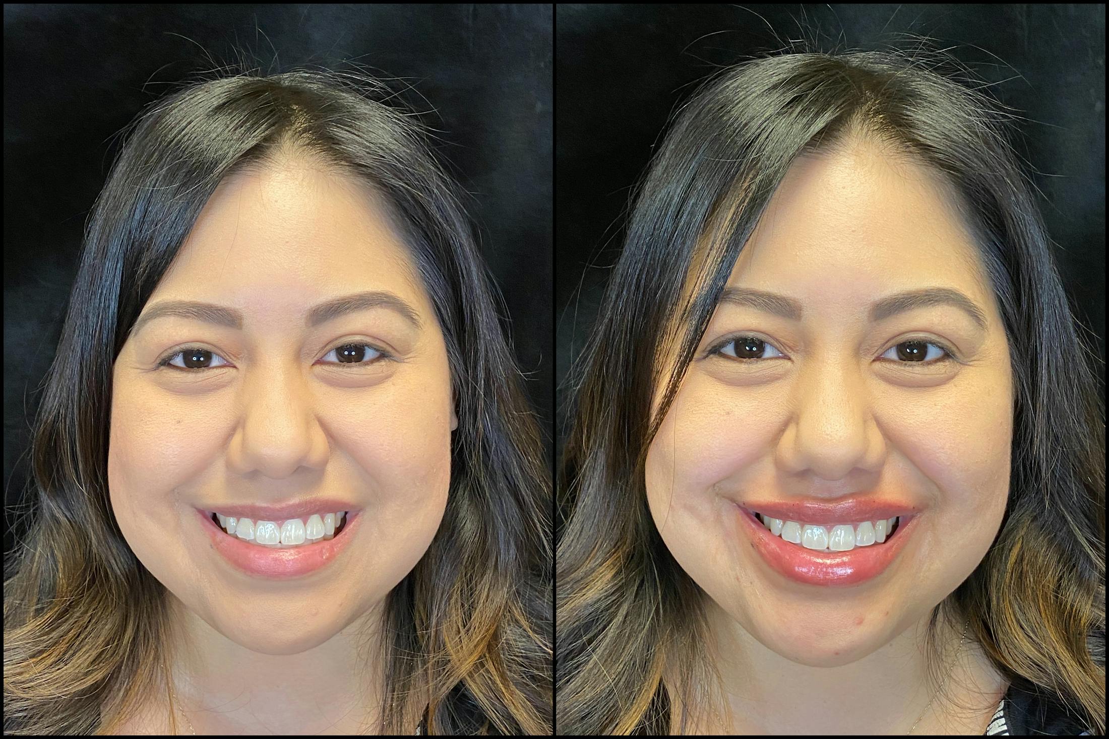 Patient 147538034 Dermal Fillers Before And After Photos Modern Womens Health Gynecology