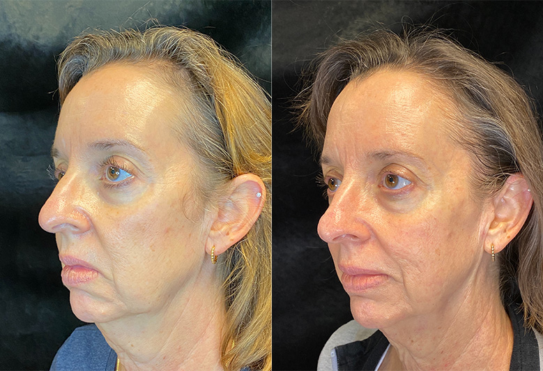 Patient 147538088 | Morpheus8 Before & After Photos | Modern Women's ...