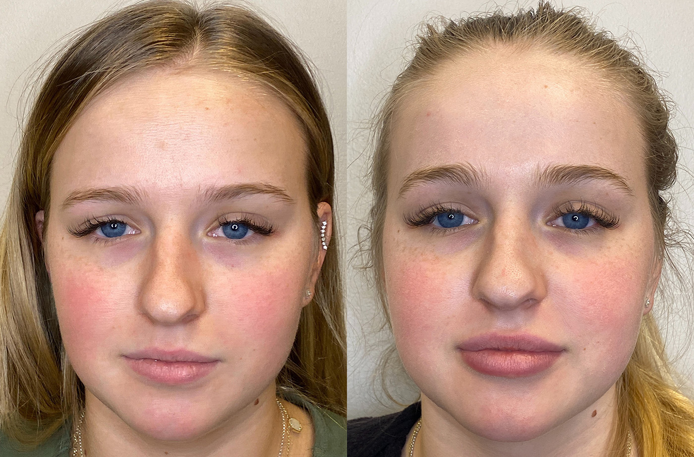 Patient 147538360 Dermal Fillers Before And After Photos Modern Women