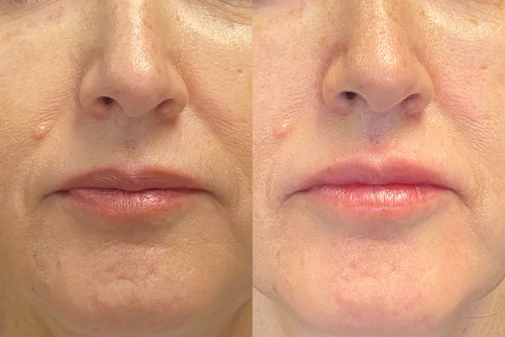 Patient 148257636 Dermal Fillers Before And After Photos Modern Women