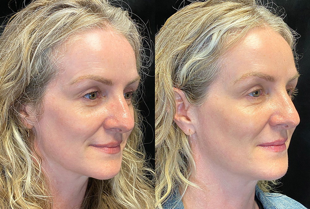 Patient 289095 Dermal Fillers Before And After Photos Modern Womens Health Gynecology