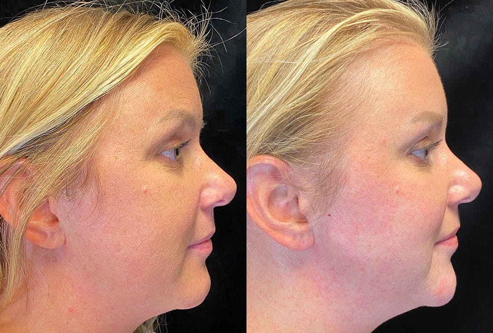 Patient 760371 Dermal Fillers Before And After Photos Modern Womens Health Gynecology
