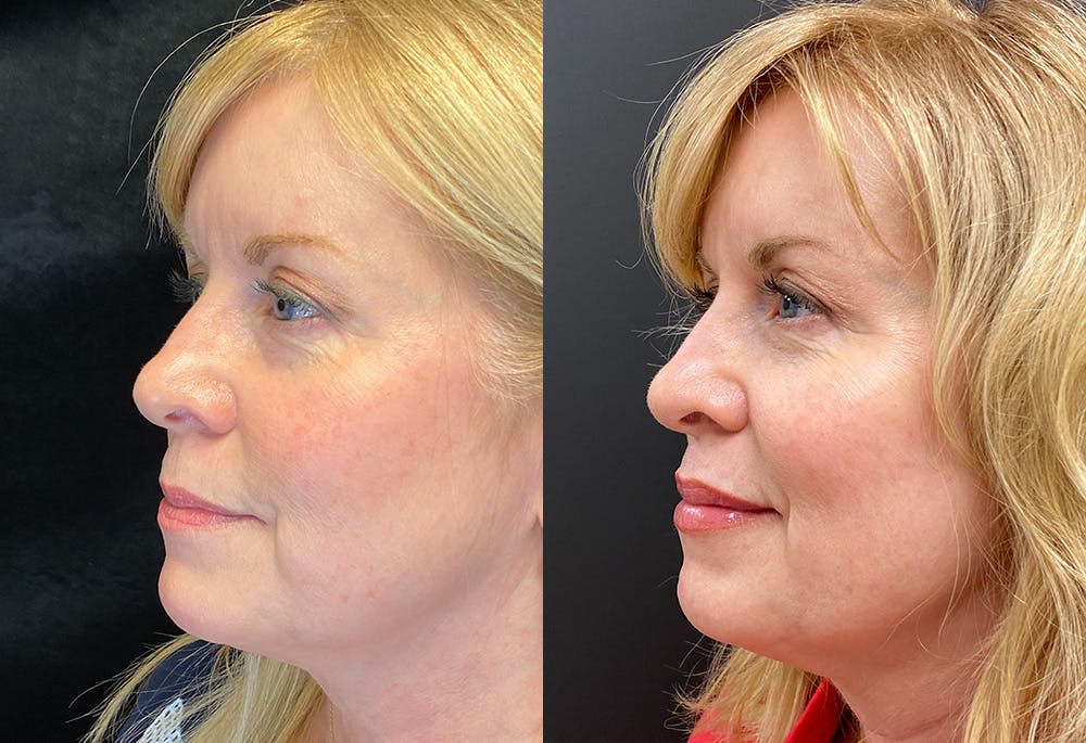 Patient 945609 Dermal Fillers Before And After Photos Modern Womens