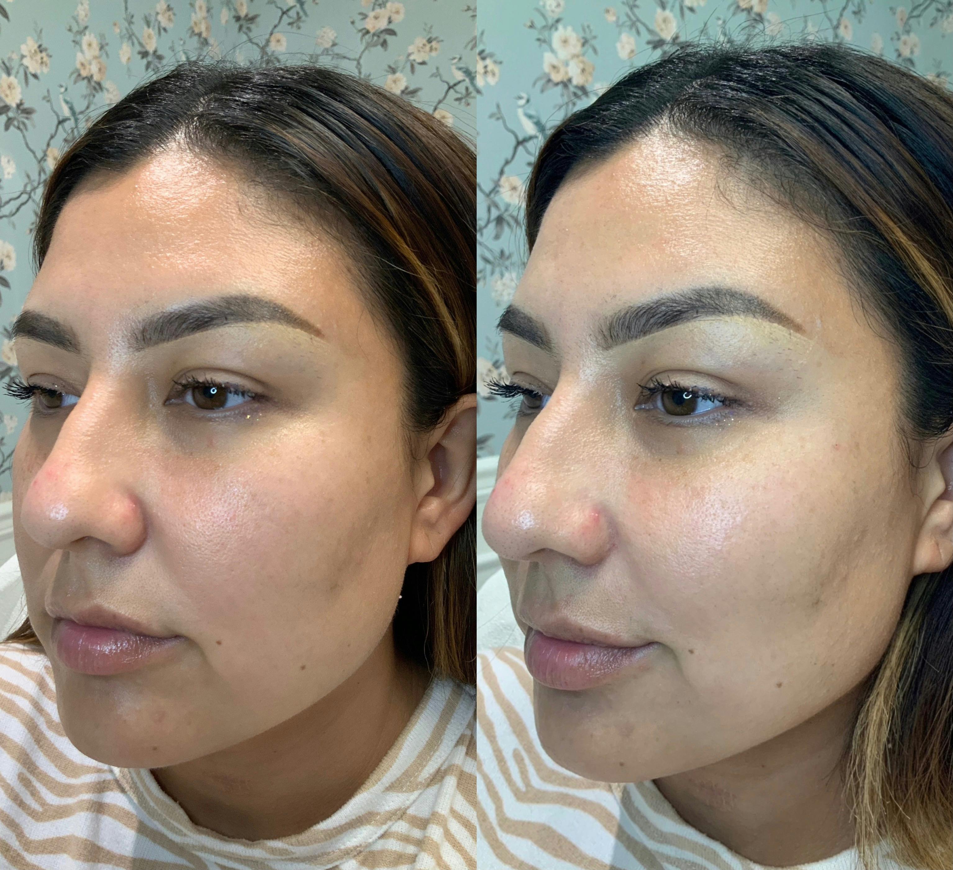 Dermal Fillers Before & After Photos | EuroPhoria